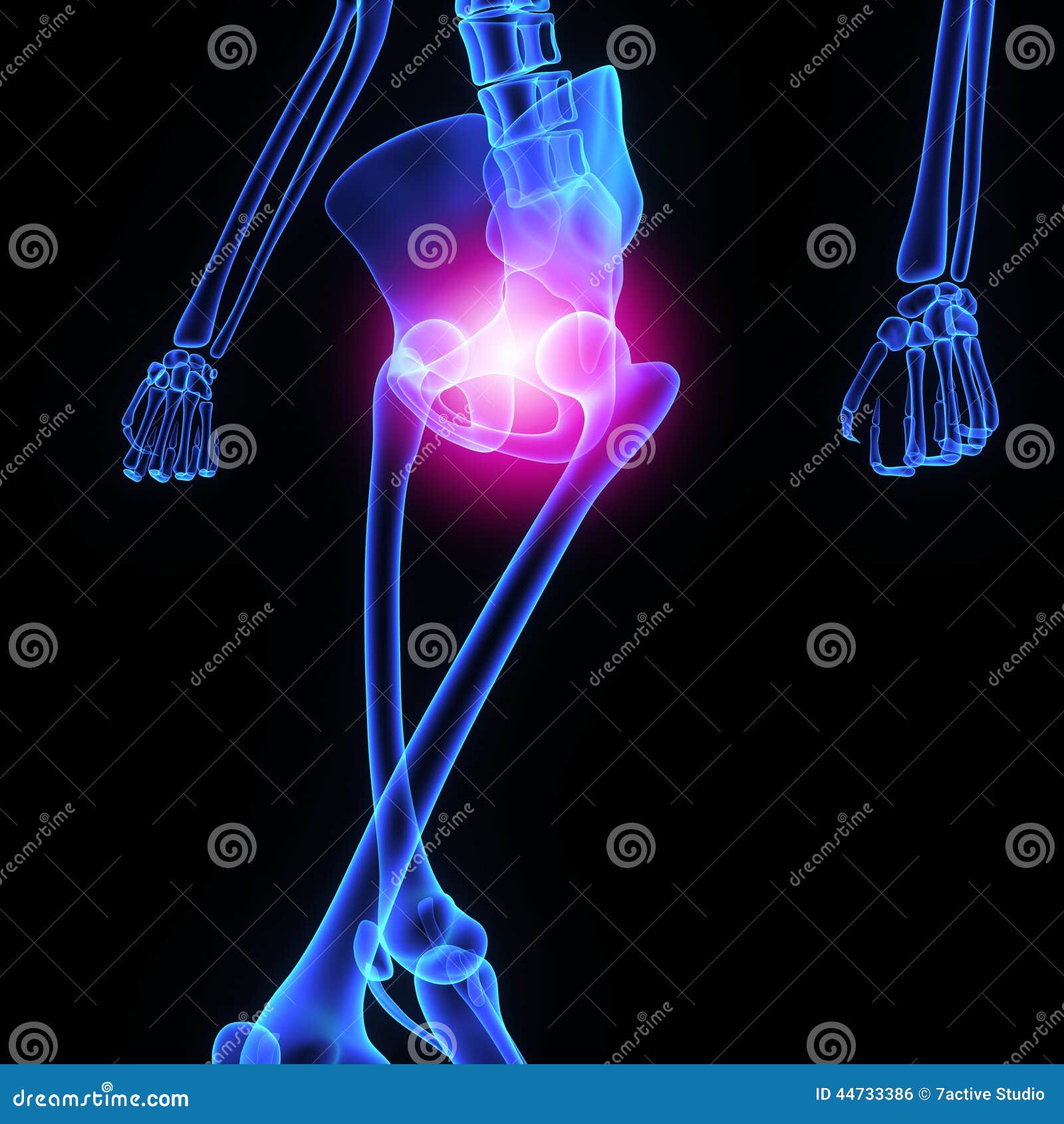 Osteoartritis Van Heupverbinding Stock Illustratie - Illustration of ...