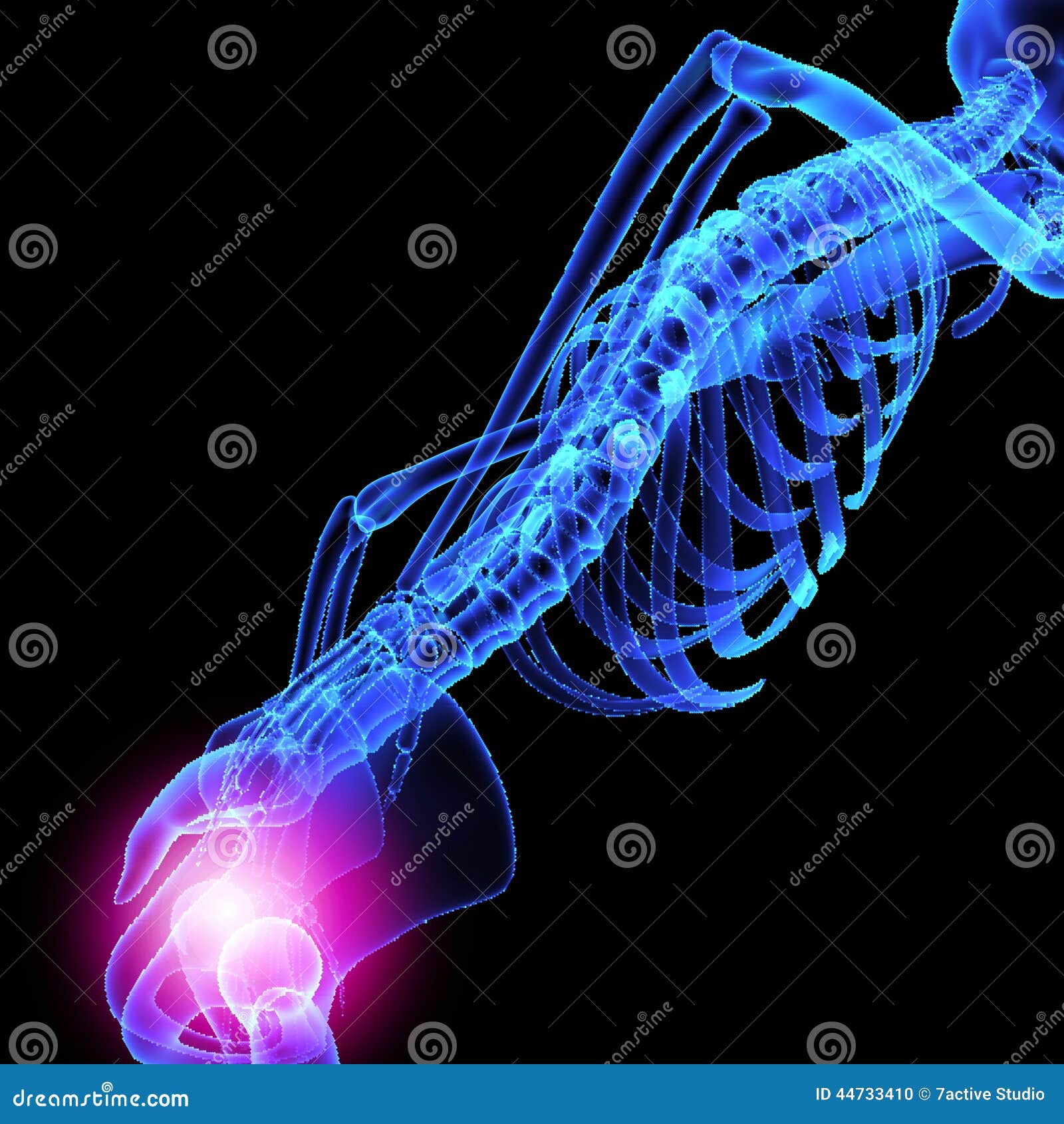 Osteoartritis Van Heupverbinding Stock Illustratie - Illustration of ...