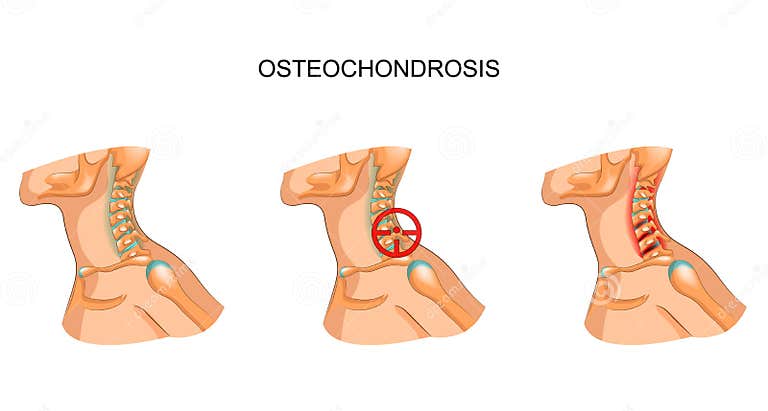 Osteochondrosis De Las Vértebras Cervicales Ilustración del Vector - Ilustración de espinal ...
