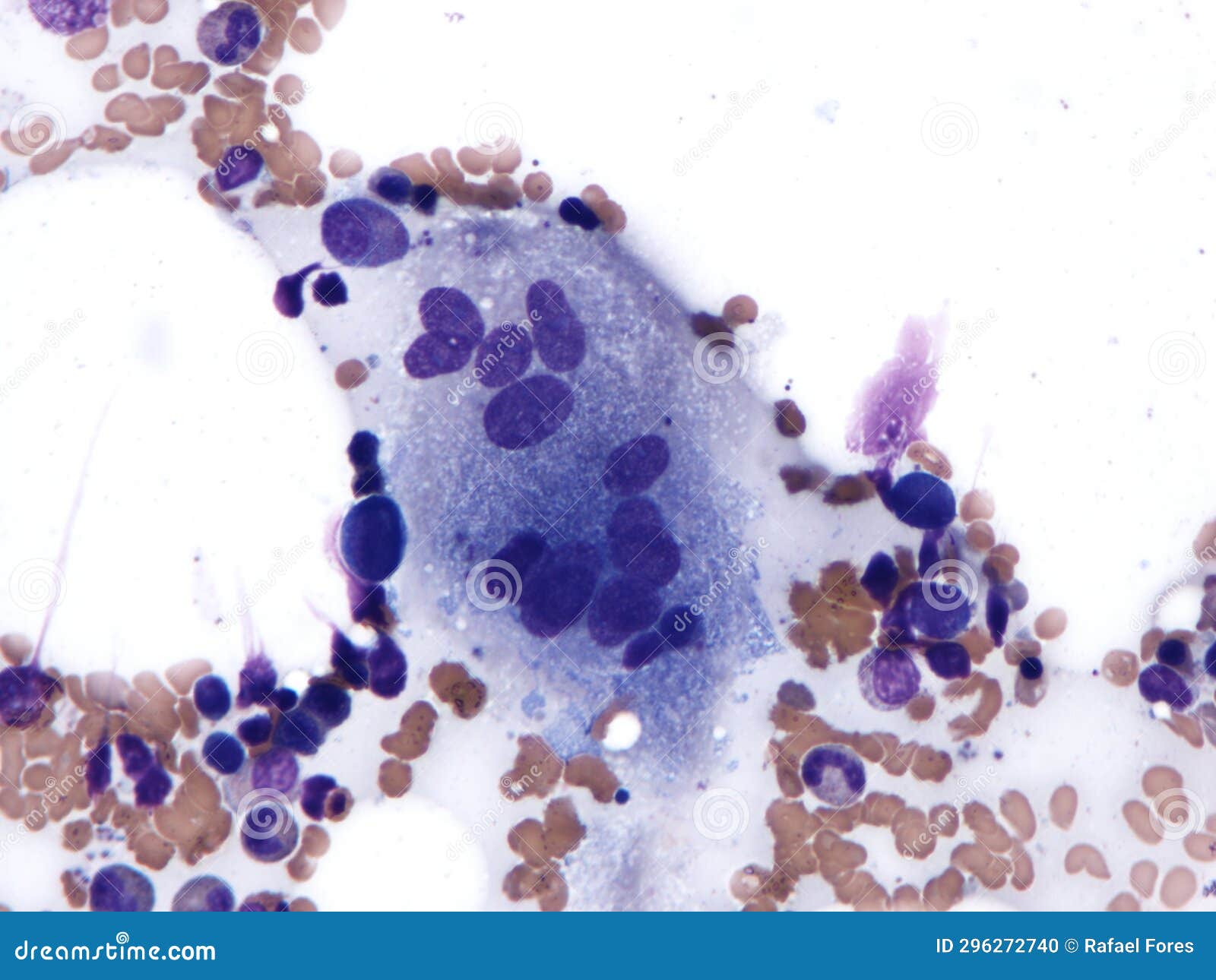 Osteoclast in bone marrow stock photo. Image of medical - 296272740