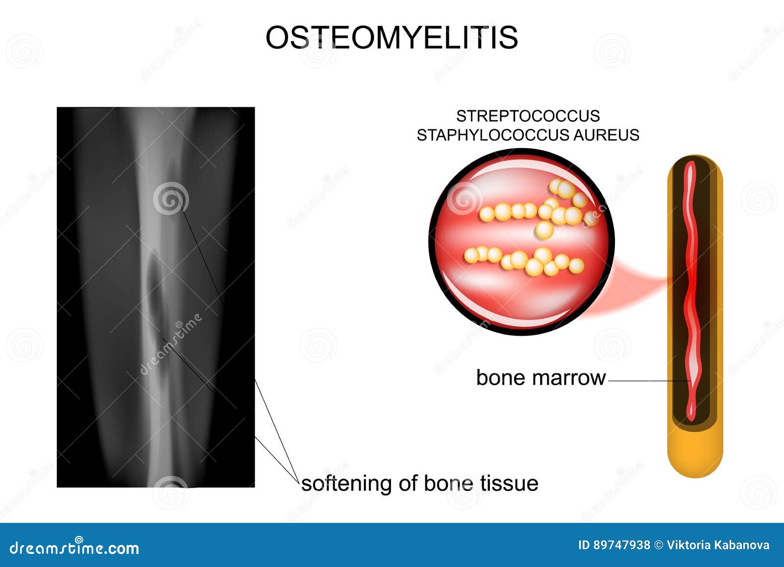 Osteomielite Delle Lesioni Dell'osso Illustrazione Vettoriale ...