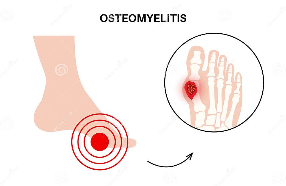 Osteomyelitis Of Feet Stock Illustration Illustration Of Acute 291529666