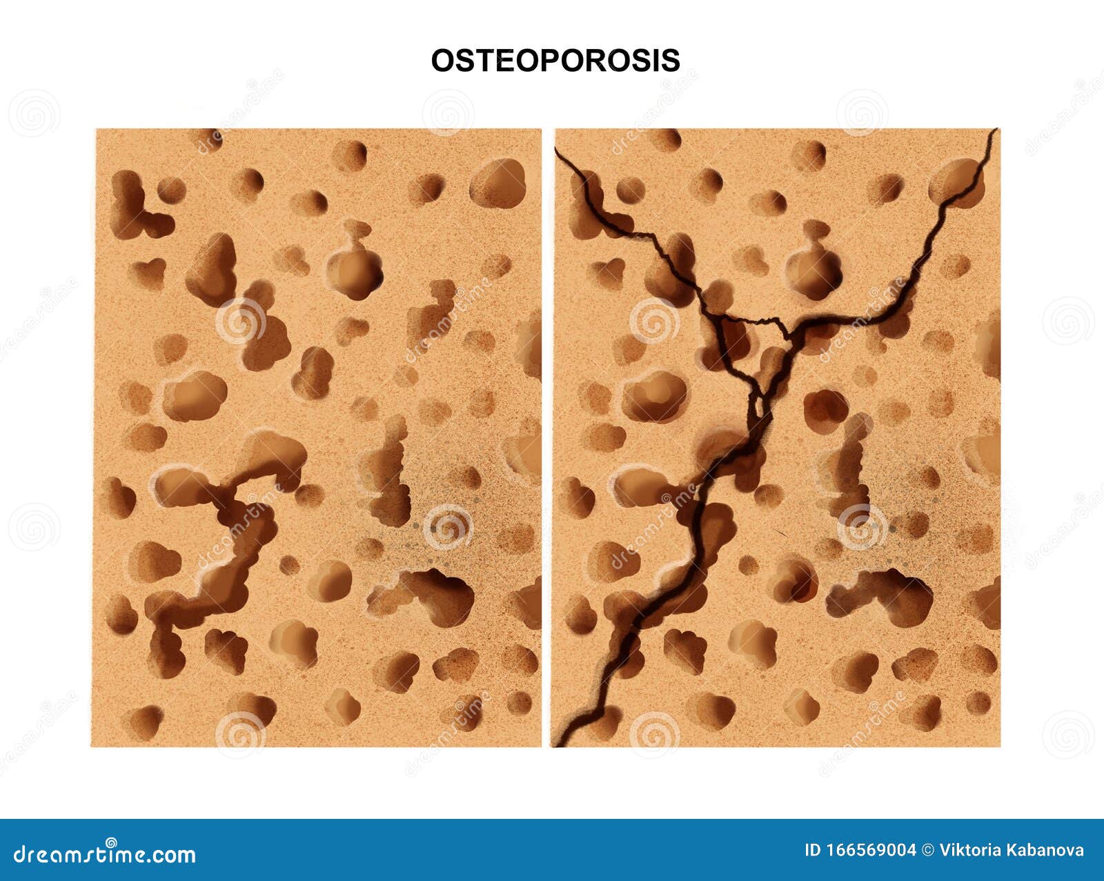 Osteoporos stock illustrationer. Illustration av krökning - 166569004