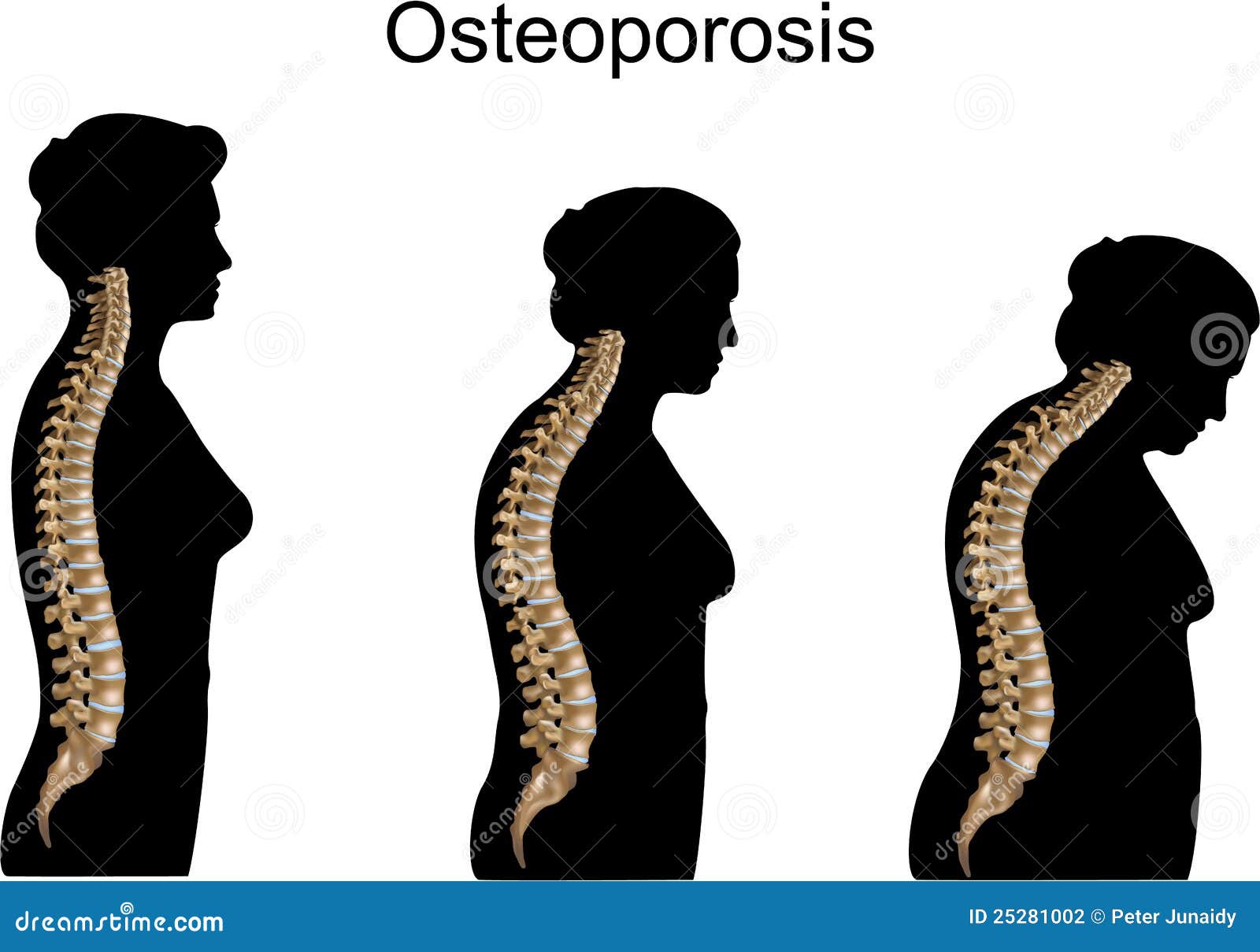 Osteoporose Stockfotografie - Bild: 25281002