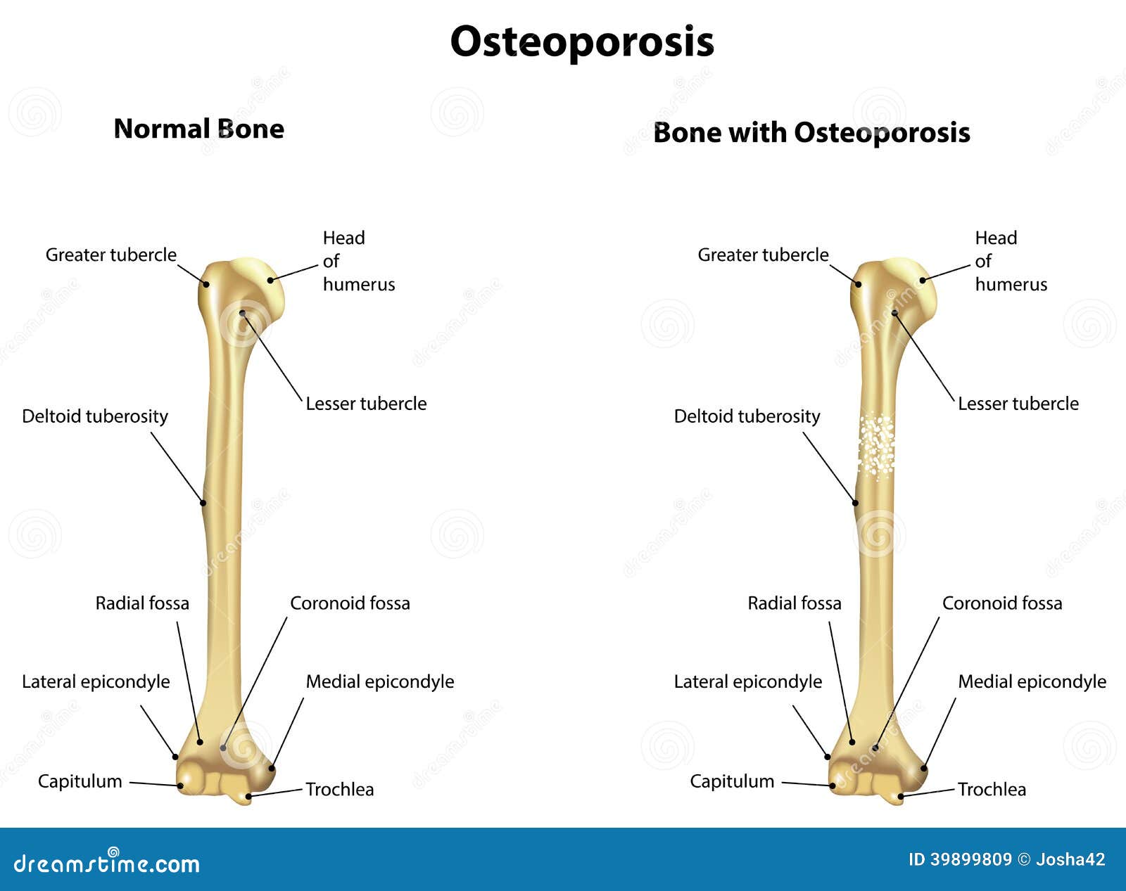 Osteoporose-Humerus-Arm-Ellbogen Vektor Abbildung - Illustration von ...