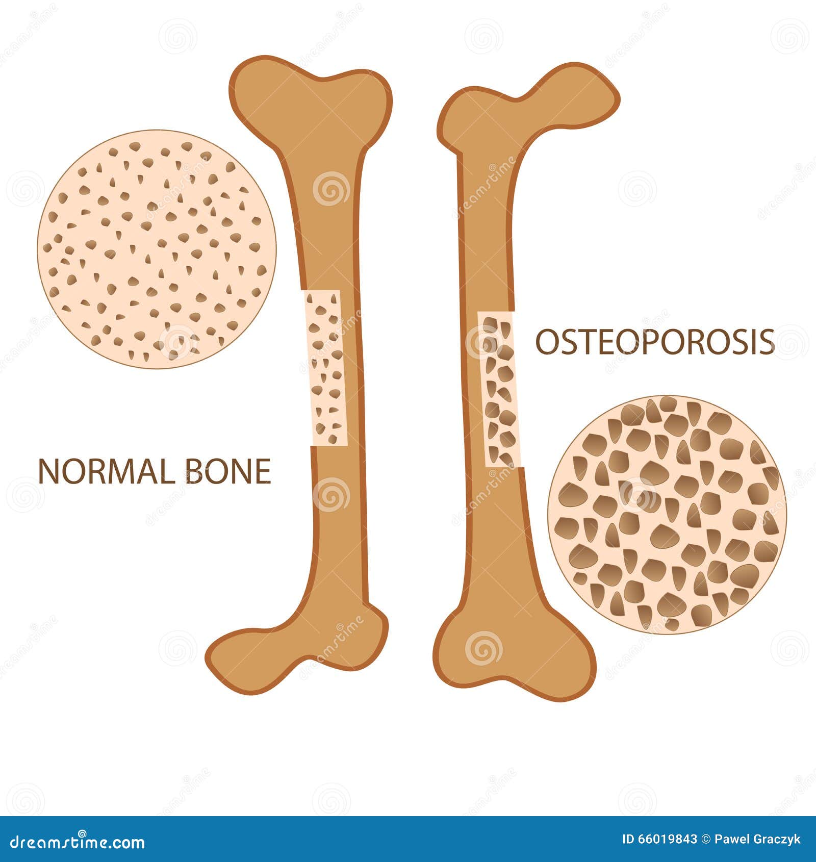 Osteoporosis, Health Care. Tiny Female Character Sitting On Huge Bone ...