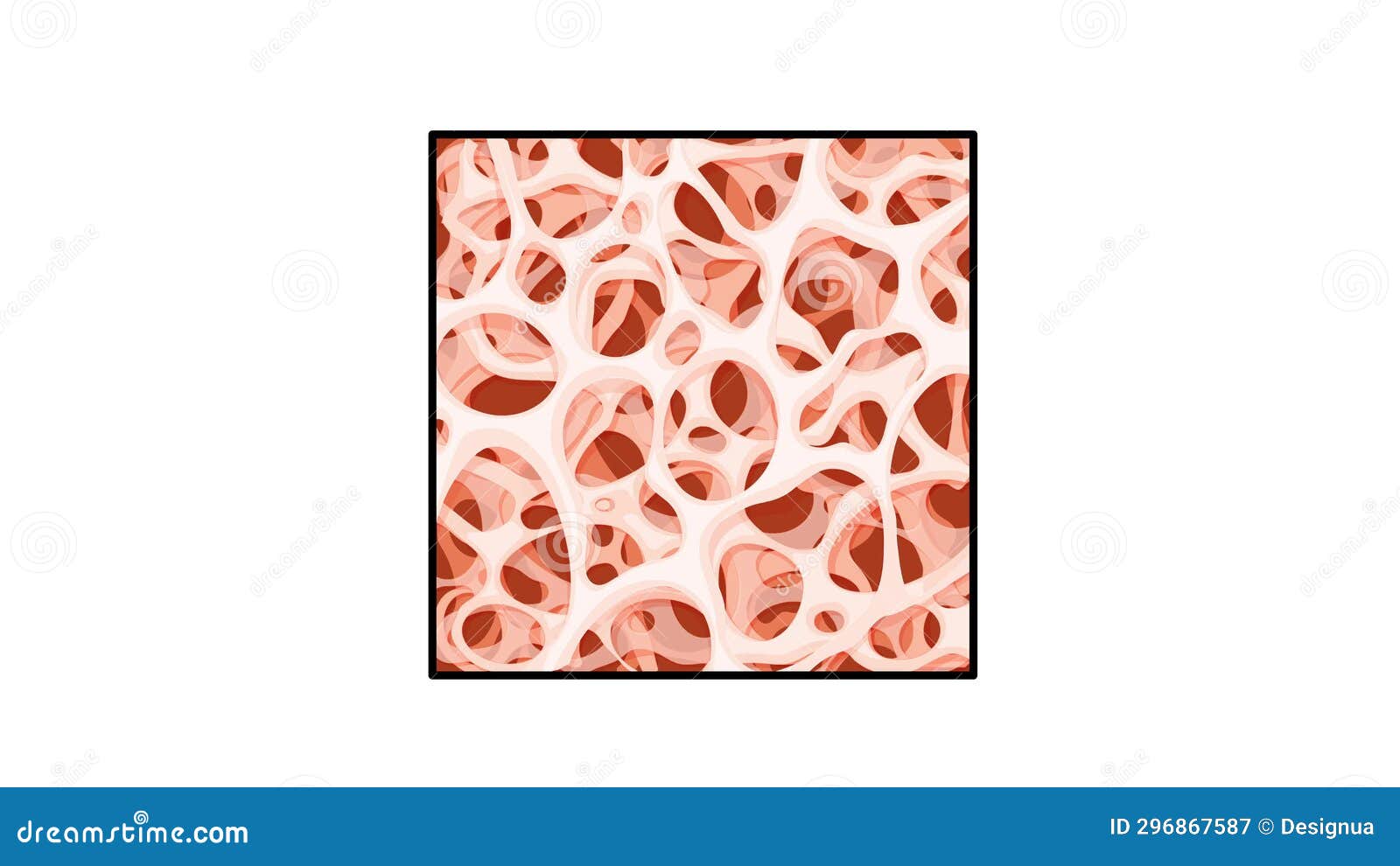 Osteoporosis. bone disease stock video. Video of disease - 296867587