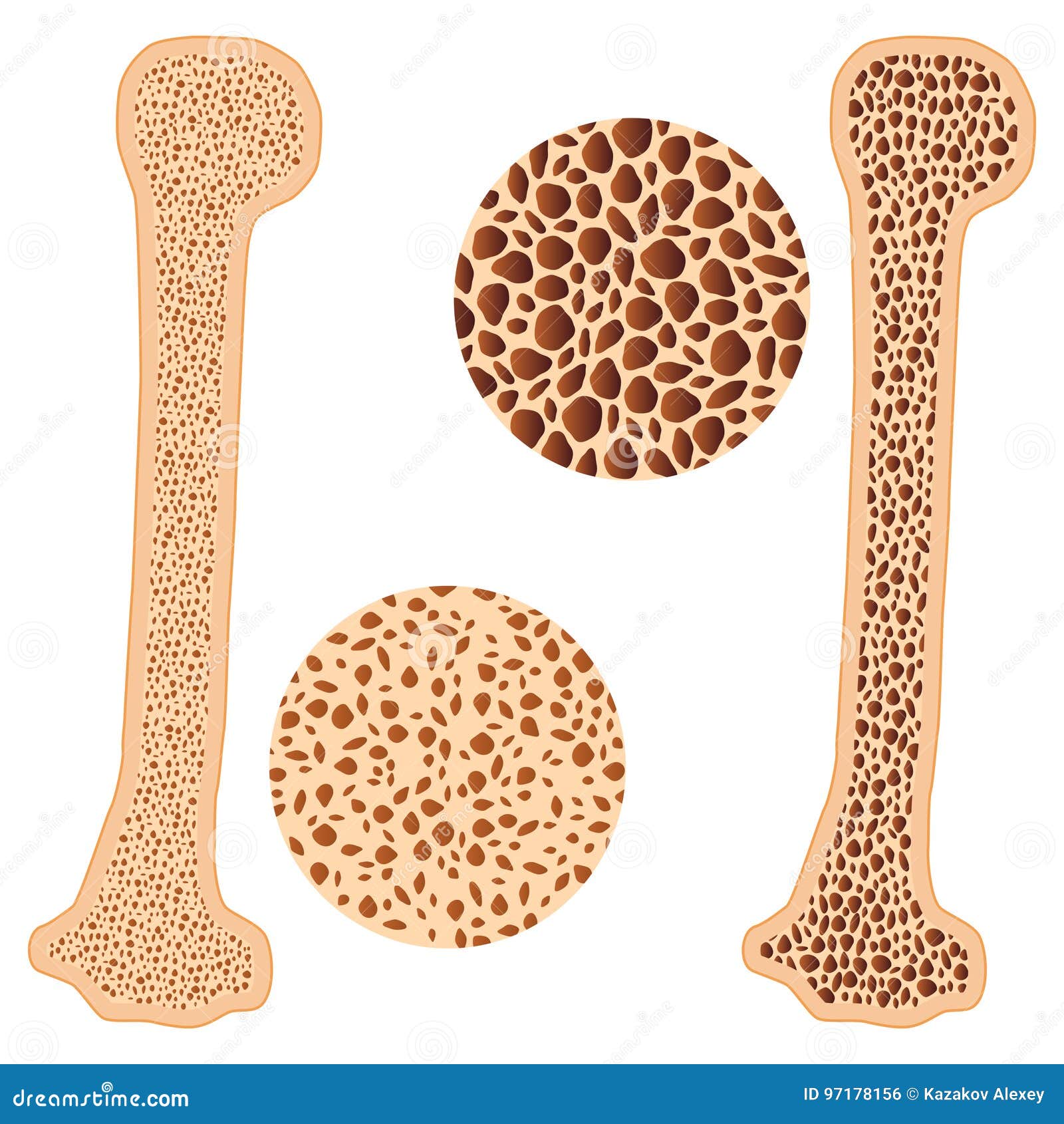Osteoporosis Bone and Healthy Bone. Stock Vector - Illustration of ...