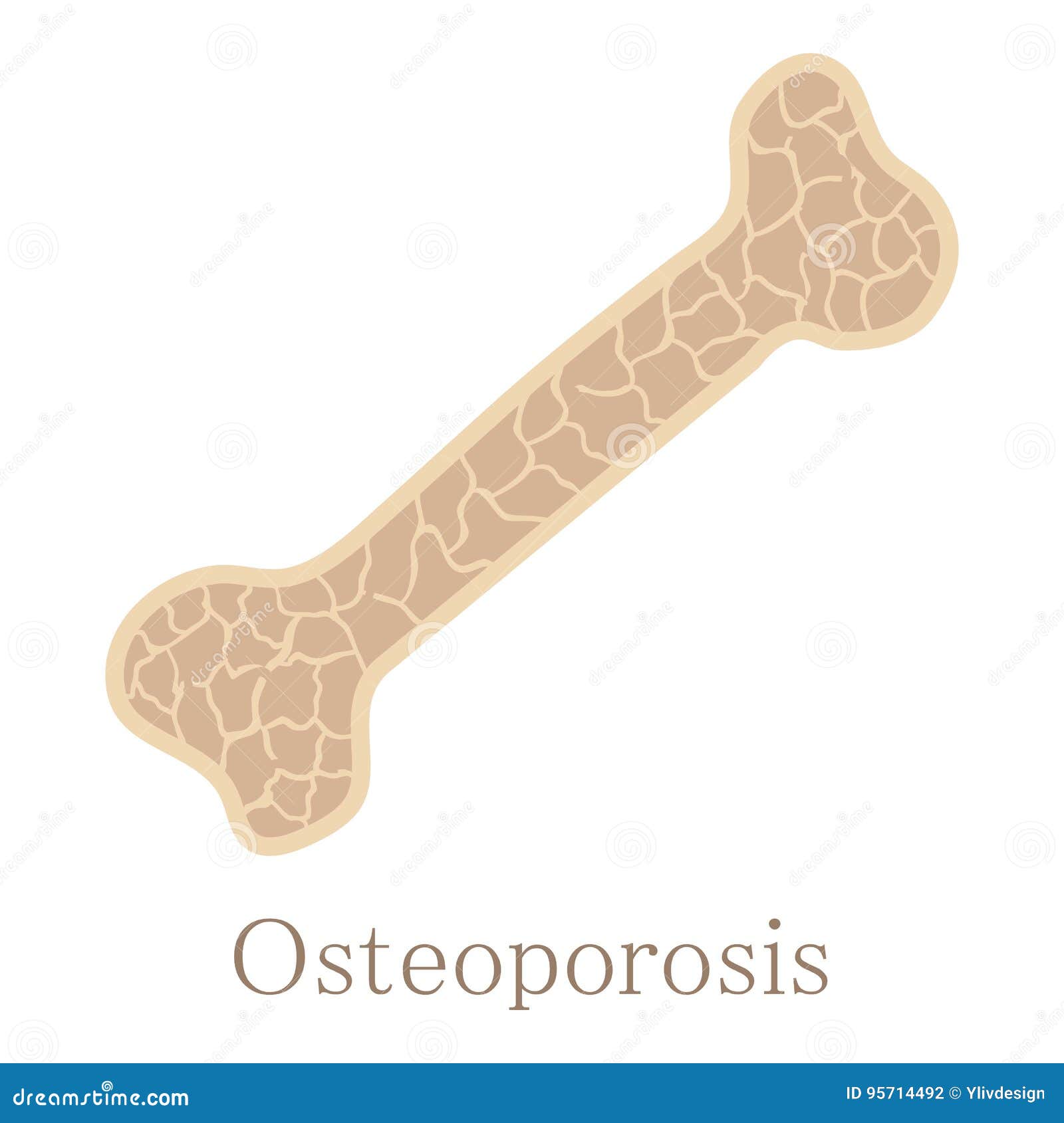 Osteoporosis Bone Density Loss Disease Medical Infographics Cartoon ...