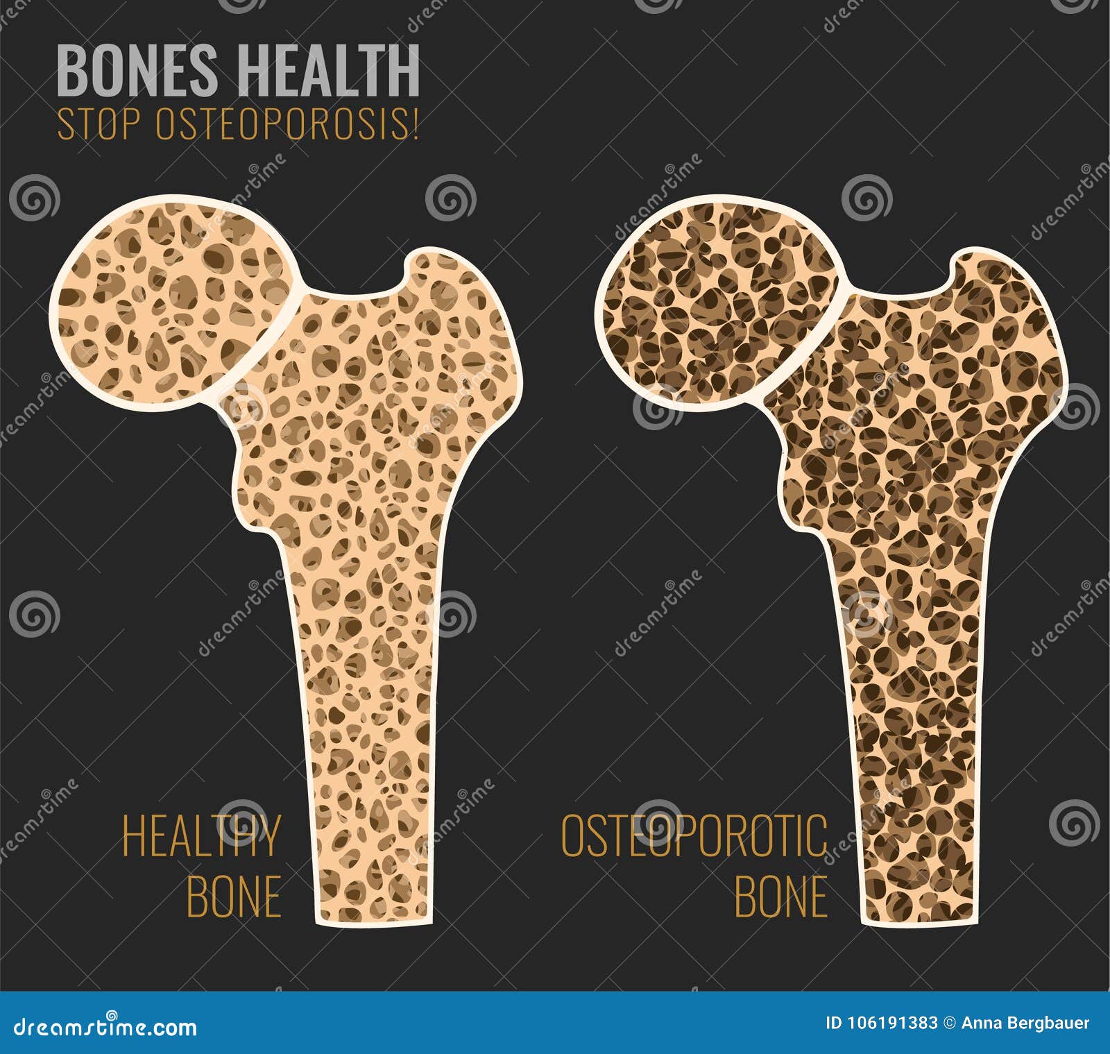 Osteoporosis Bone image stock vector. Illustration of biology - 106191383 Osteoporosis Bone image stock vector. Illustration of biology - 106191383