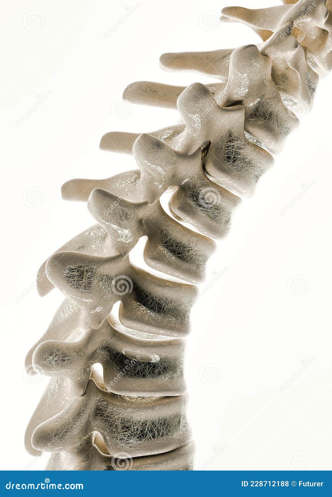 Osteoporosis Stages. Aging Process With Bone Cartoon Vector ...