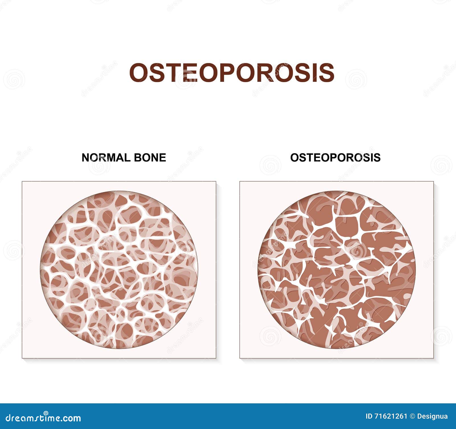 Osteoporosis stock vector. Illustration of menopause - 71621261 Osteoporosis stock vector. Illustration of menopause - 71621261