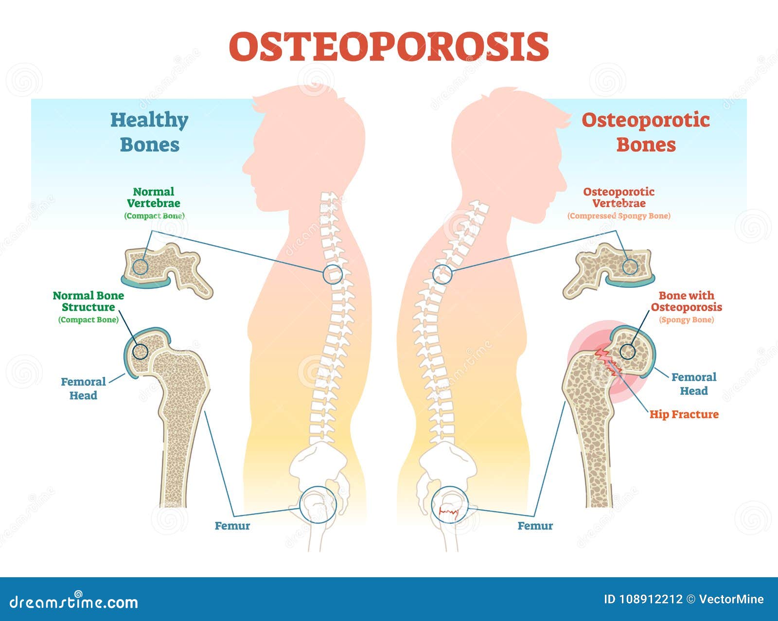Osteoporosis Examples Vector Illustration Diagram with Bone Density ... Osteoporosis Examples Vector Illustration Diagram with Bone Density ...