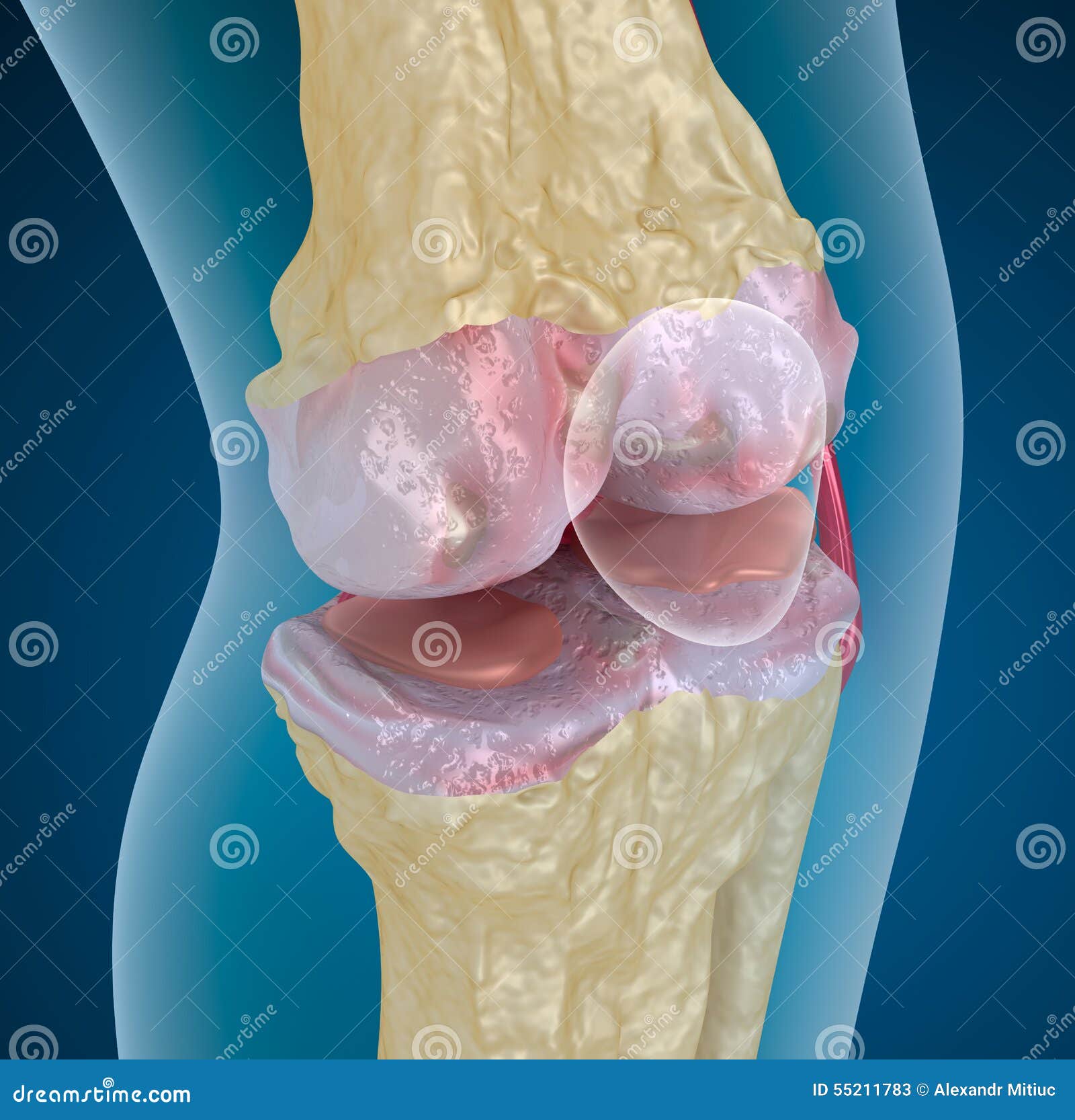 Osteoporosis of the Knee Joint Stock Illustration - Illustration of ...