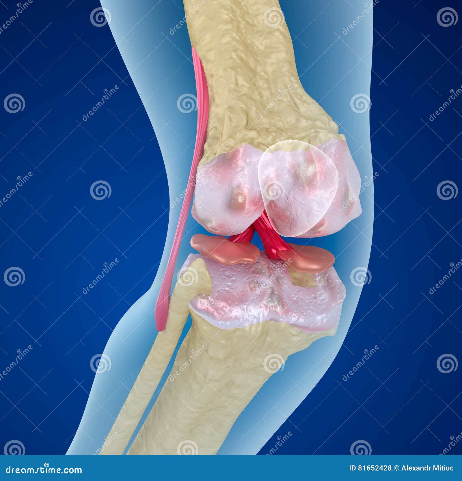 Osteoporosis of the Knee Joint Stock Illustration - Illustration of ...