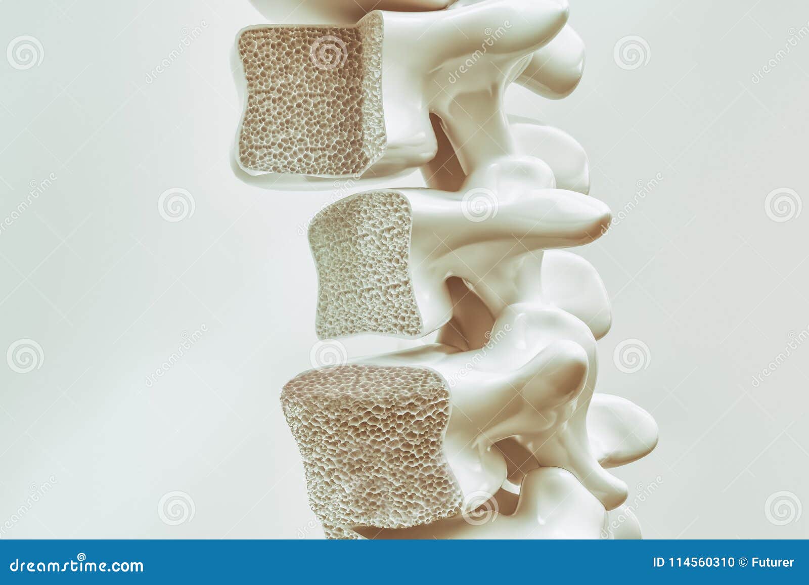 Osteoporosis on the Spine - 3d Rendering Stock Illustration ...