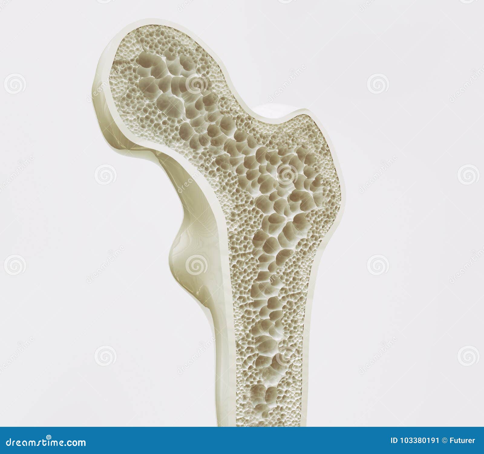 Osteoporosis Stage 1 of 4 -- 3d Rendering Stock Illustration ...