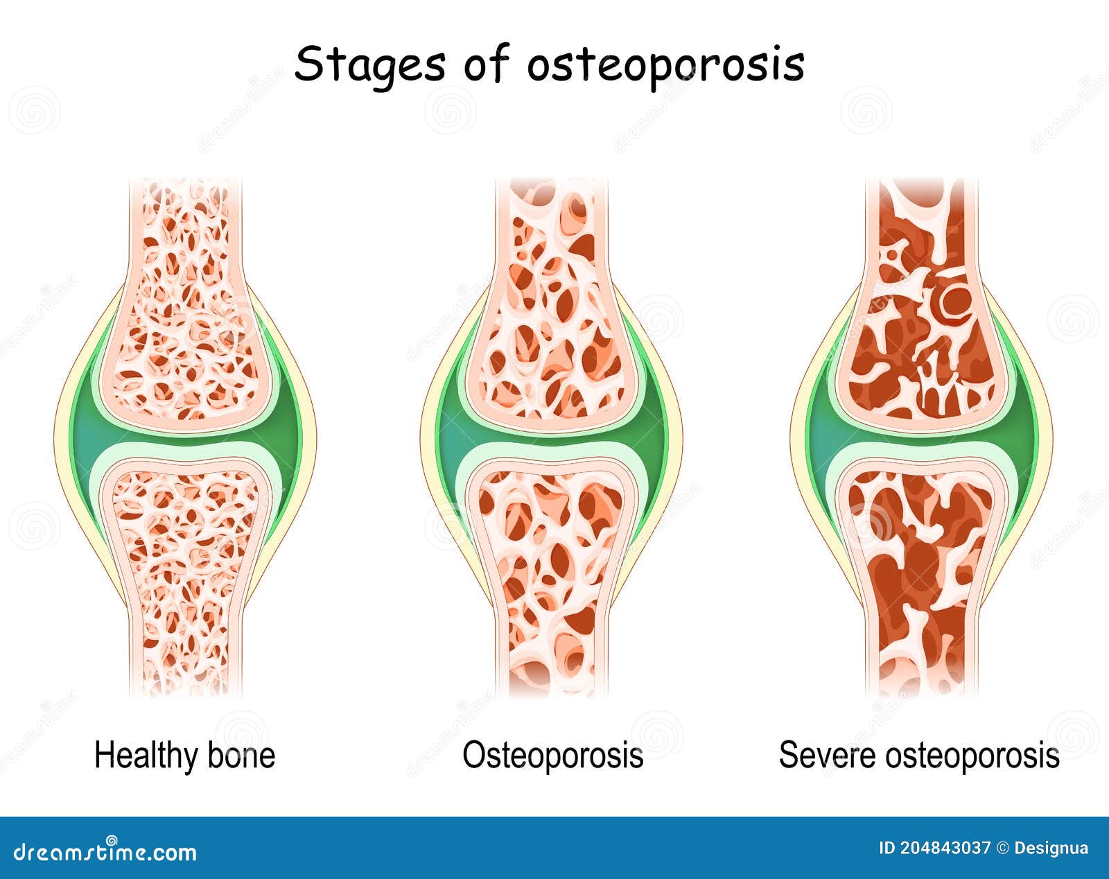 Osteoporosis Stages. Aging Process With Bone Cartoon Vector ...