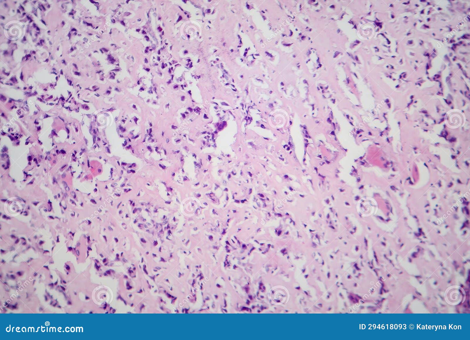 Osteosarcoma, A Malignant Bone Tumor, Light Micrograph Under The ...