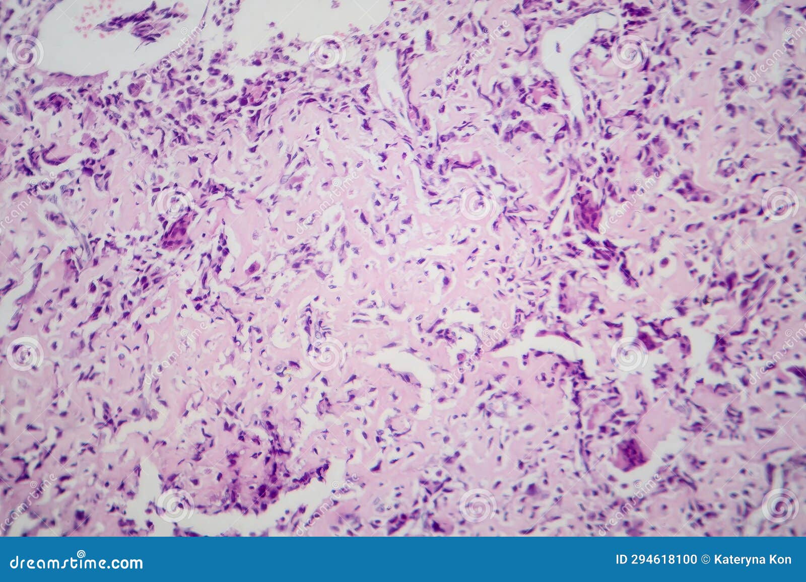 Osteosarcoma, A Malignant Bone Tumor, Light Micrograph Under The ...