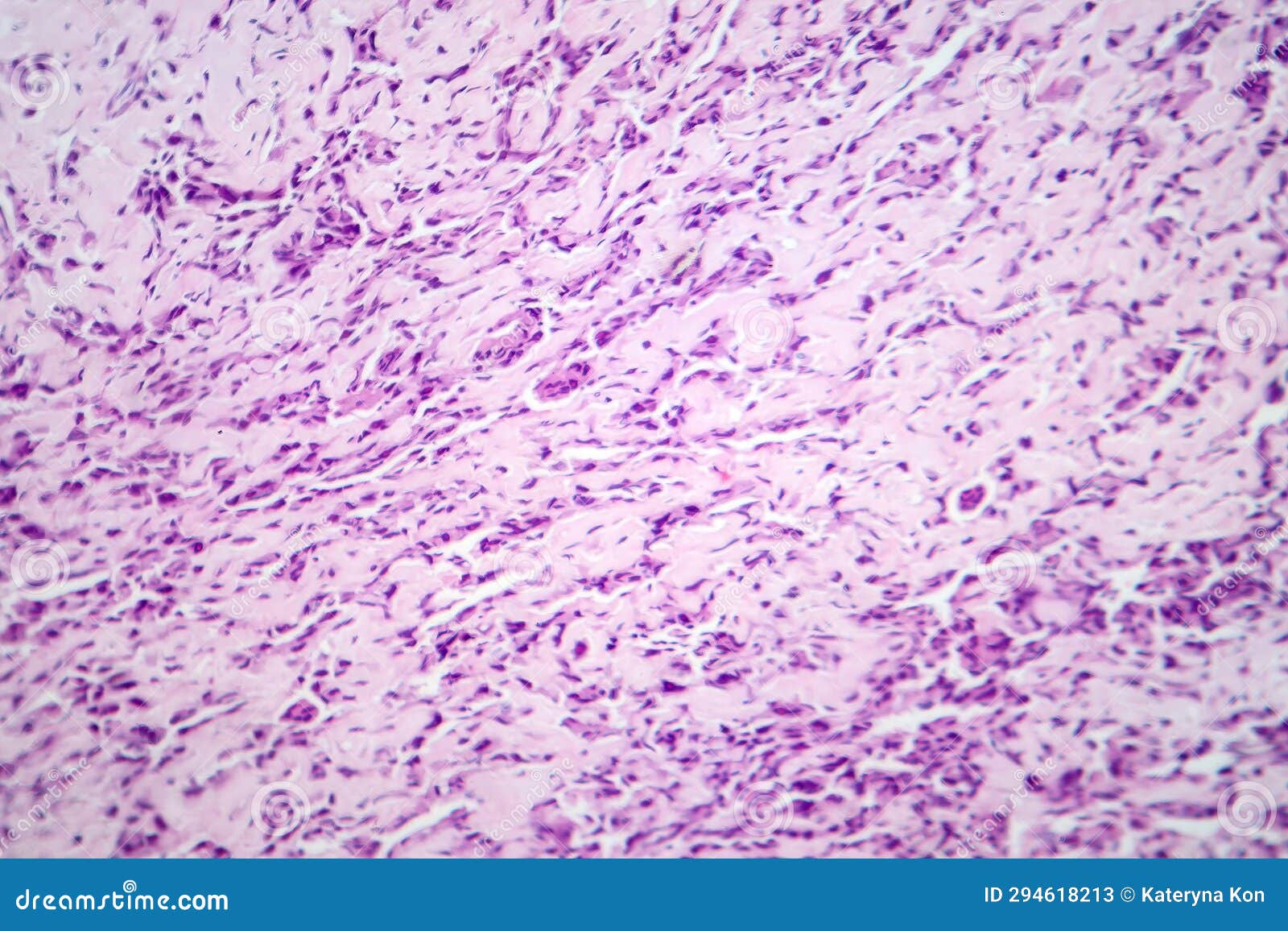 Osteosarcoma, a Malignant Bone Tumor, Light Micrograph Under the ...