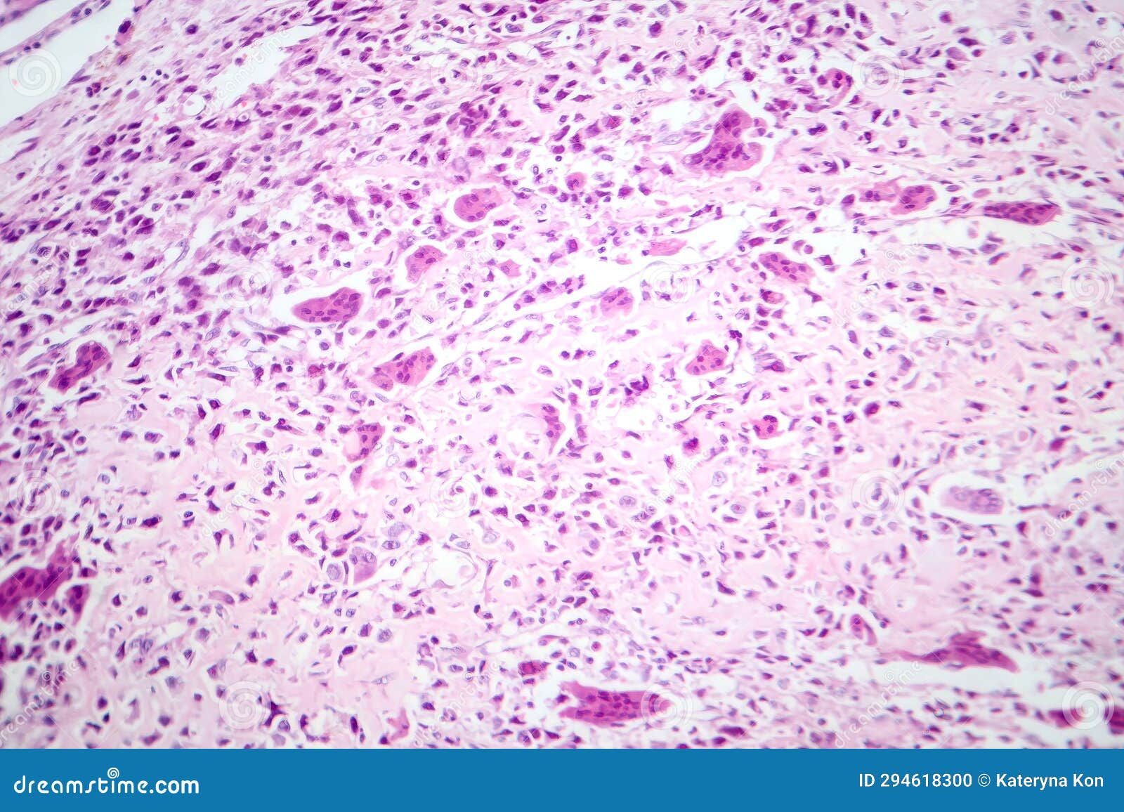 Osteosarcoma, a Malignant Bone Tumor, Light Micrograph Under the ...