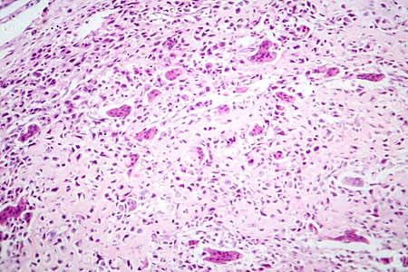 Osteosarcoma, a Malignant Bone Tumor, Light Micrograph Under the ...