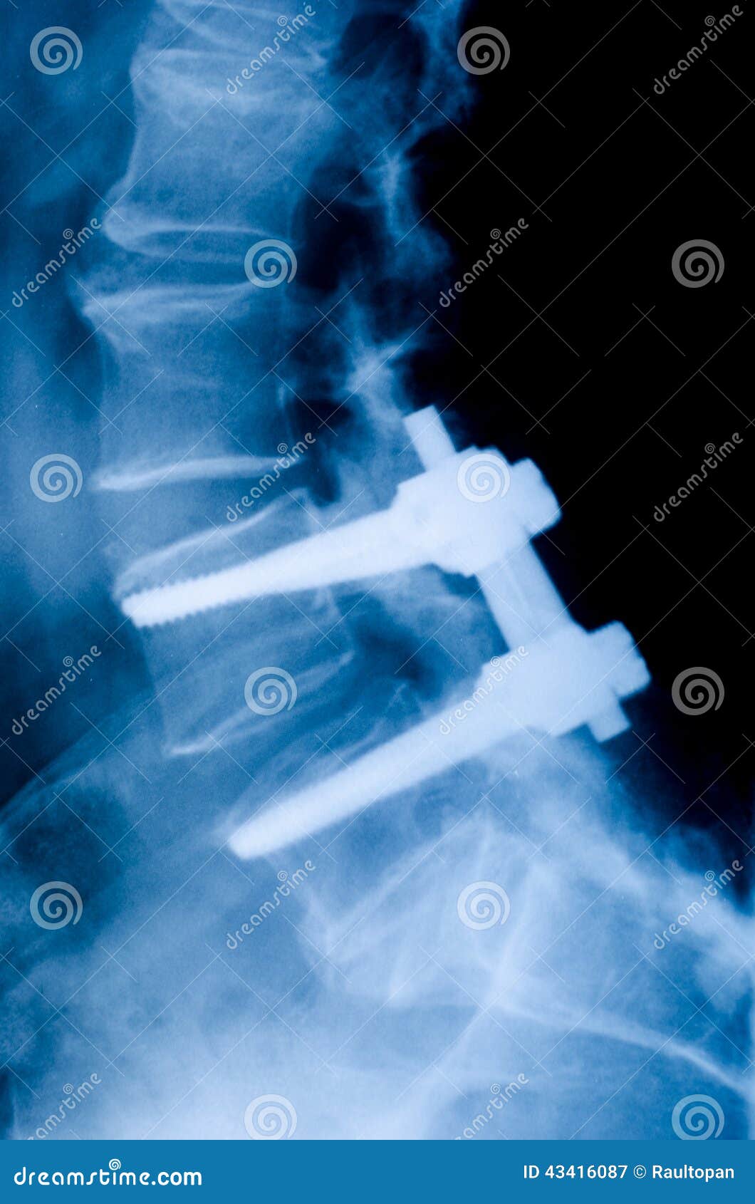 Osteosynthesis stock image. Image of osteosynthesis, lumbar - 43416087