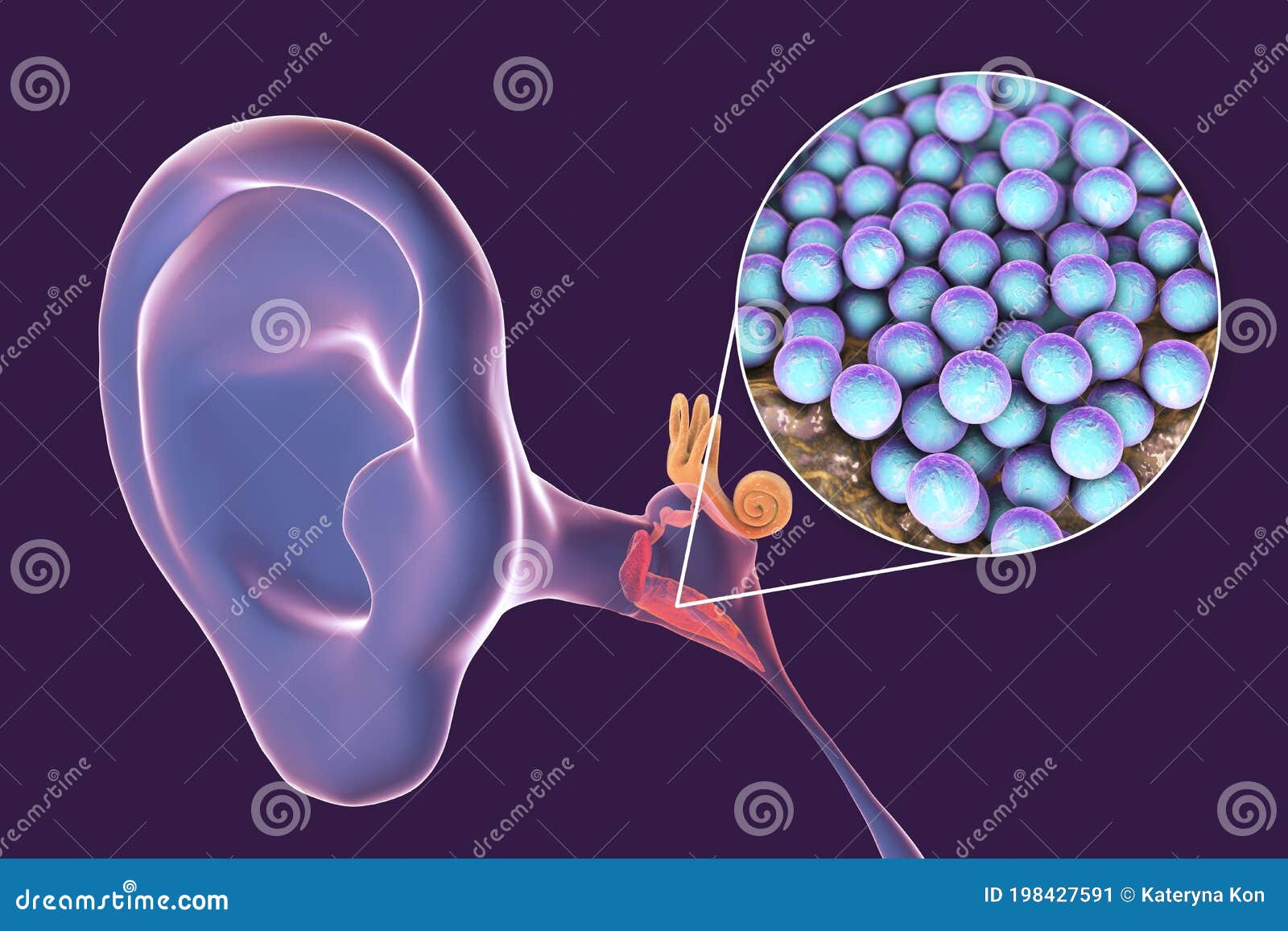 Otitis Media, Inflammatory Disease of the Middle Ear Stock Illustration ...