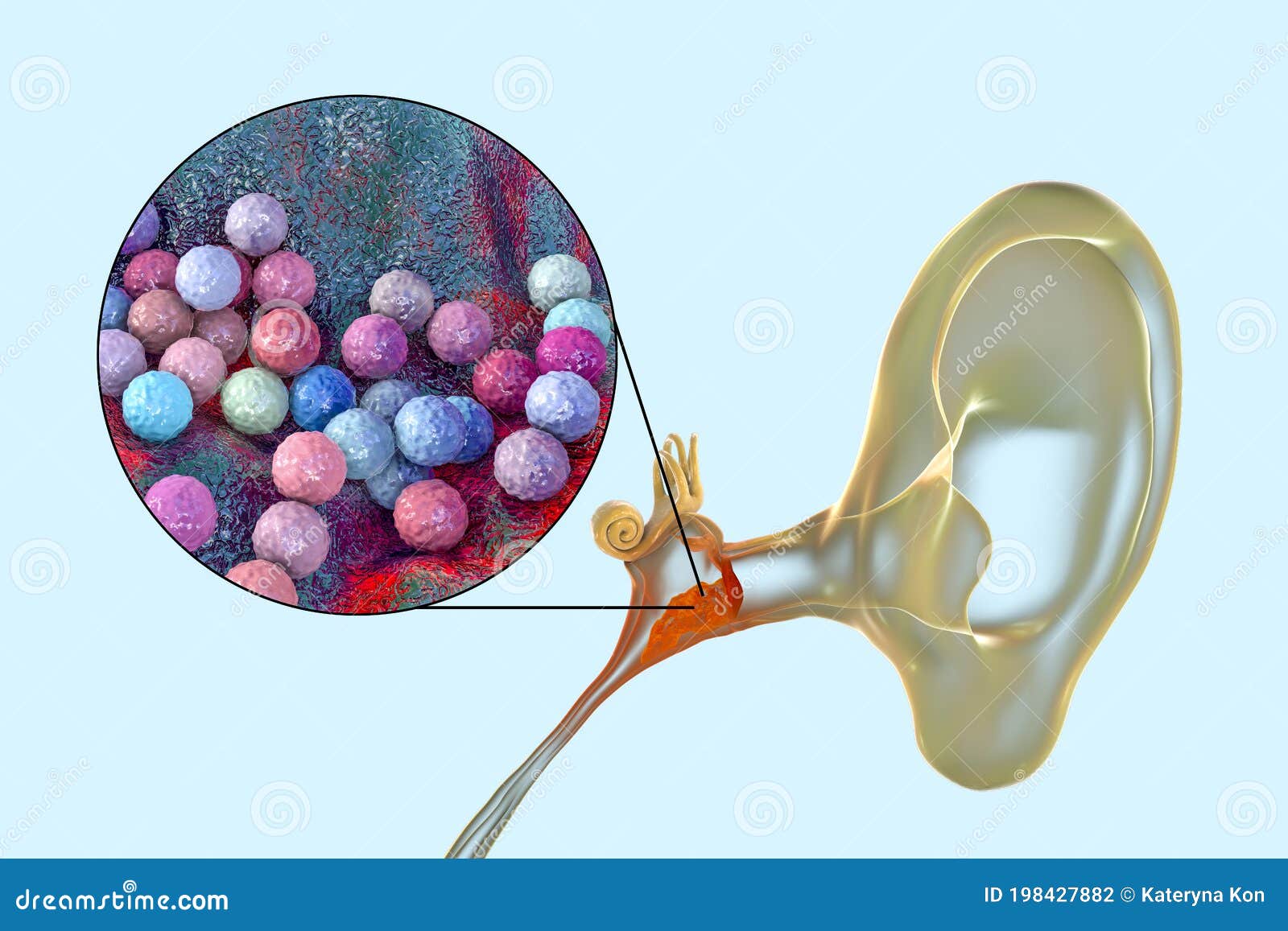 Otitis Media, Inflammatory Disease of the Middle Ear Stock Illustration ...