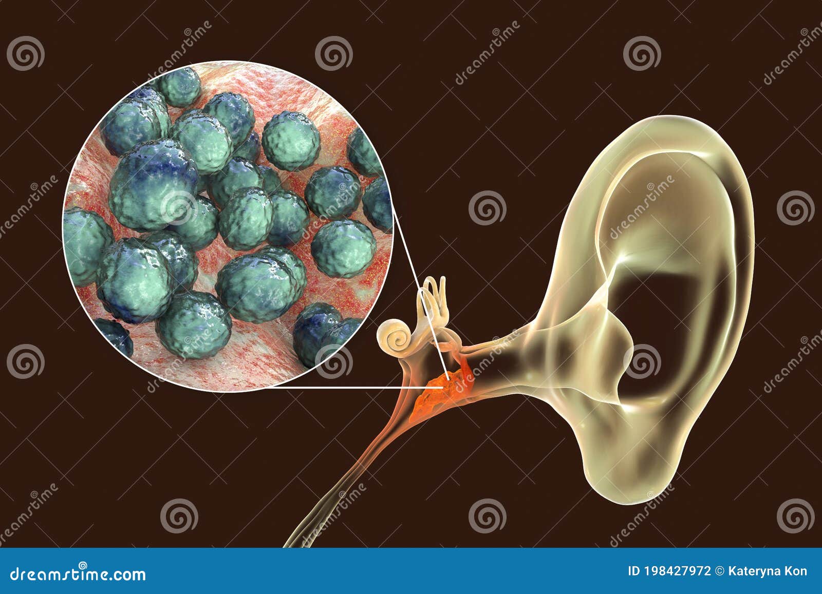 Otitis Media, Inflammatory Disease of the Middle Ear Stock Illustration ...