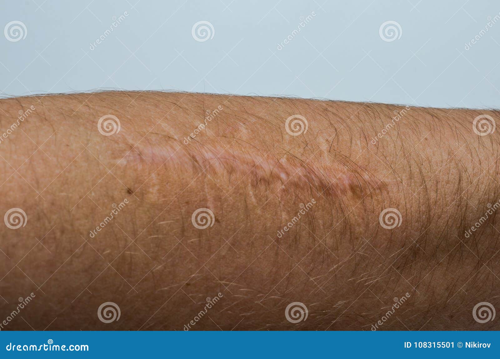 Oud Litteken Op Het Lichaam Van Chirurgie Stock Afbeelding - Image of ...