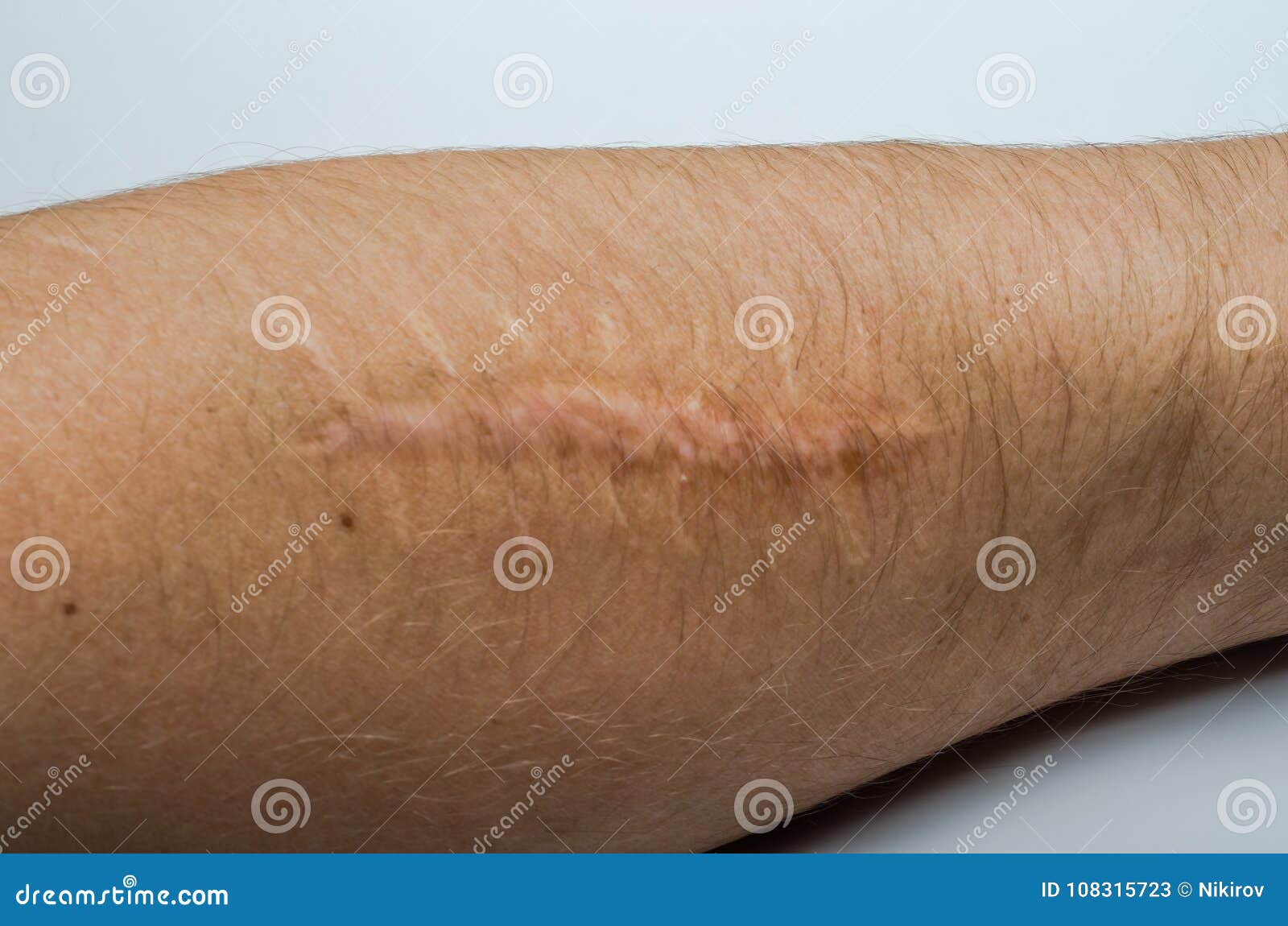 Oud Litteken Op Het Lichaam Van Chirurgie Stock Afbeelding - Image of ...