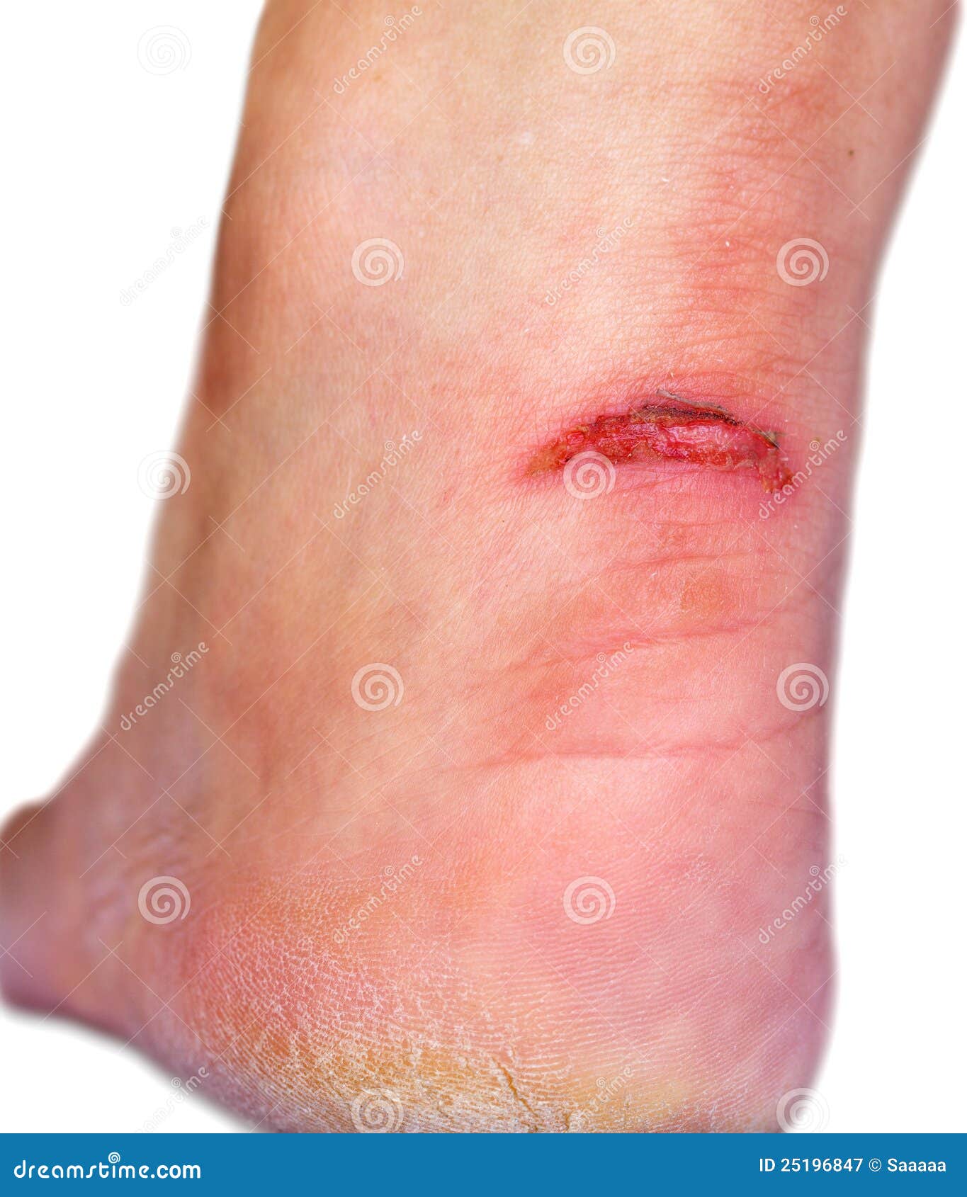 Ouvrez La Blessure Dans Le Talon Image stock - Image du blessure, causé ...