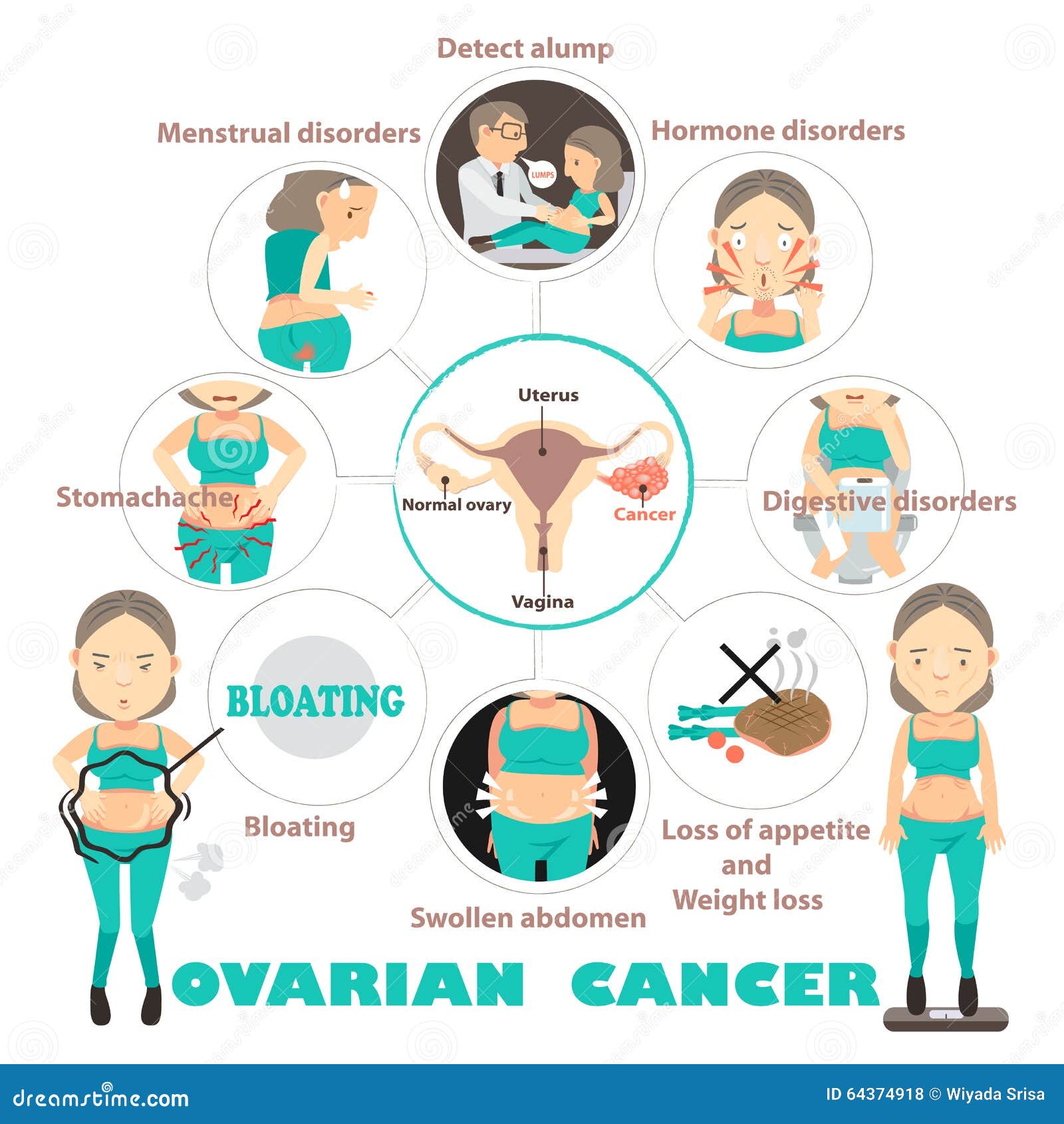 Ovariale kanker vector illustratie. Illustration of getast - 64374918
