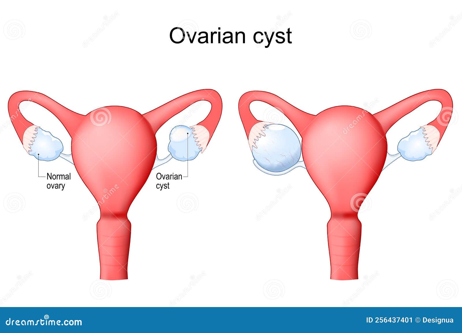Ovarian Cyst Human Uterus With Fluid Filled Sac Within The Ovary Stock Vector Illustration Of