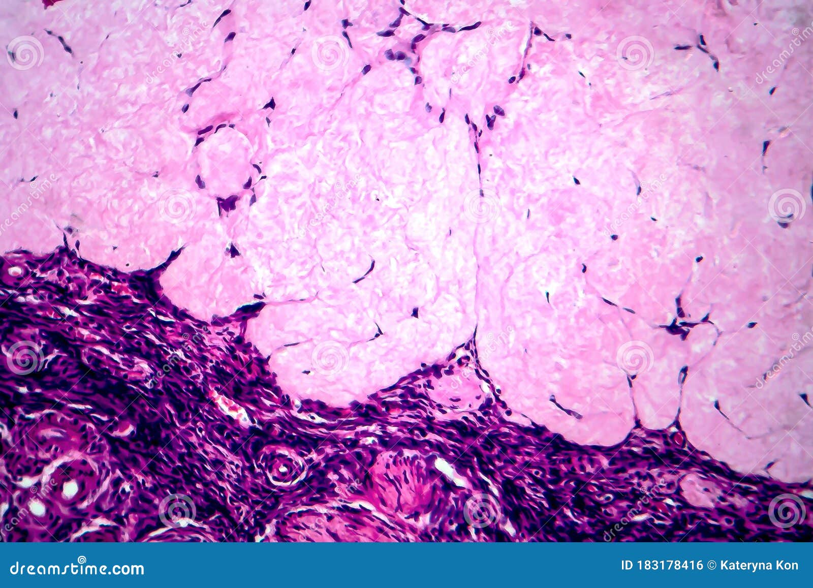 Ovarian Cyst, Light Micrograph Stock Photo - Image of microphotograph ...