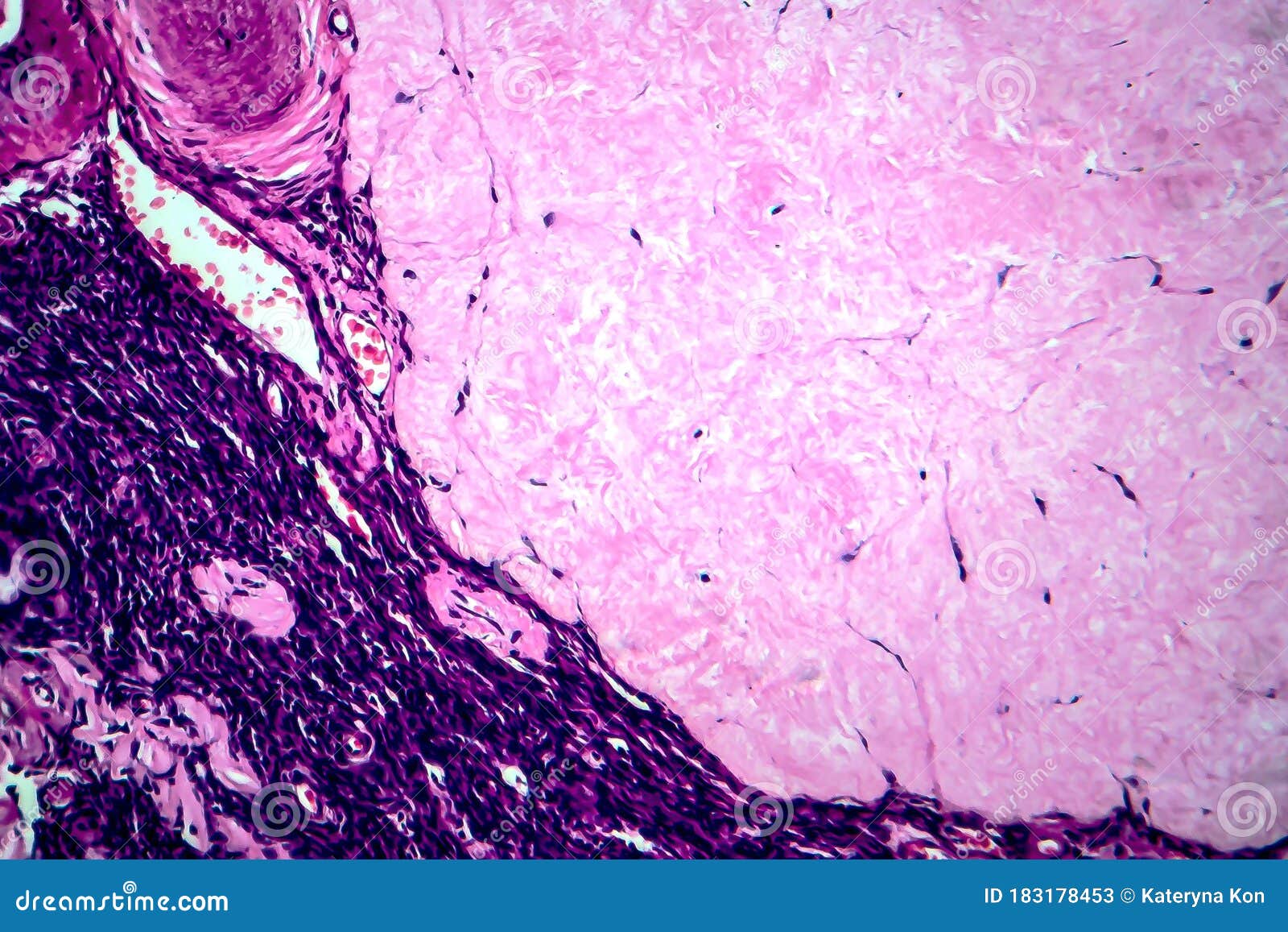 Ovarian Cyst, Light Micrograph Stock Image - Image of micro, illness ...