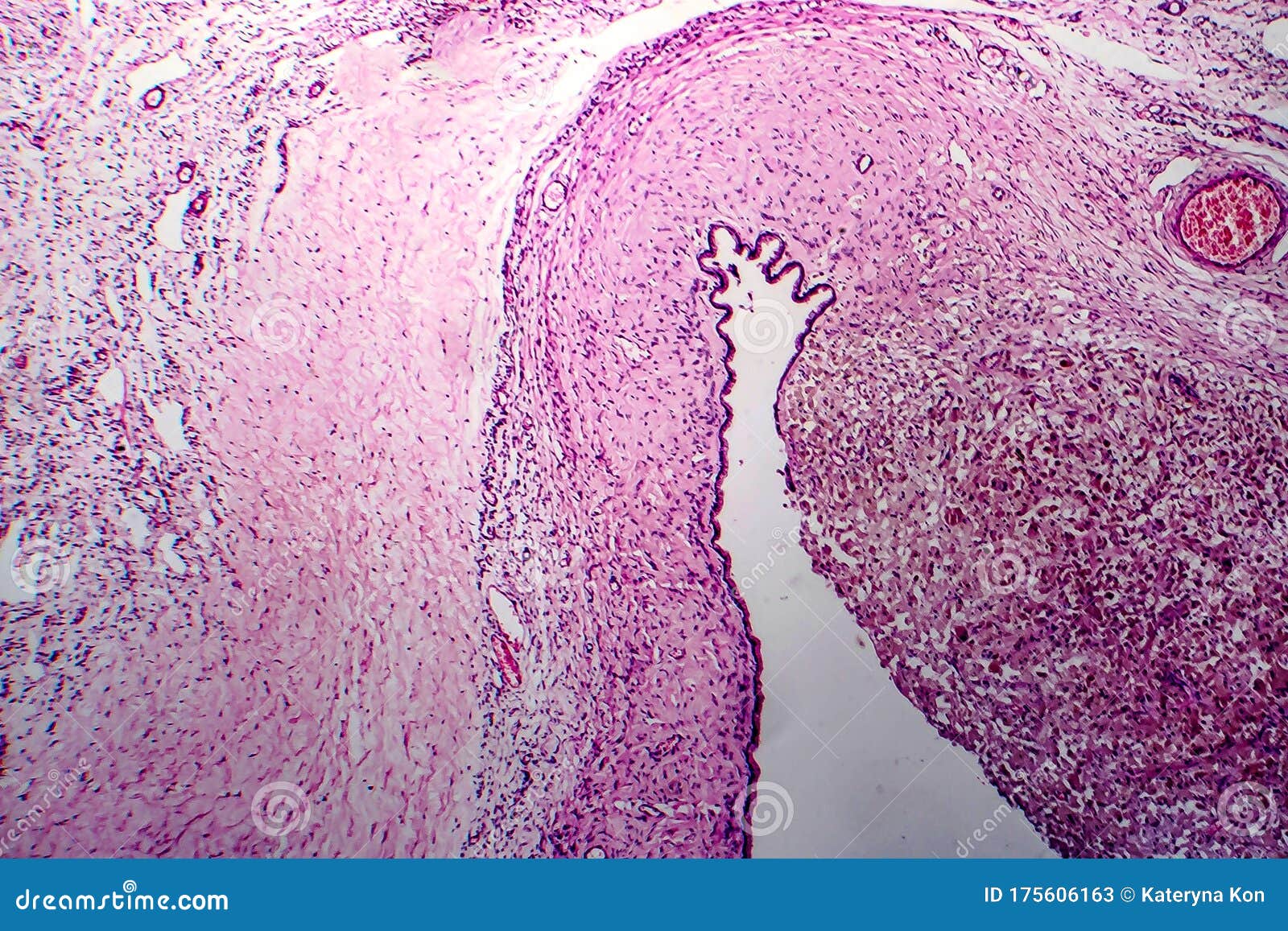 Ovarian Cyst, Light Micrograph Stock Image - Image of benign, eosin ...