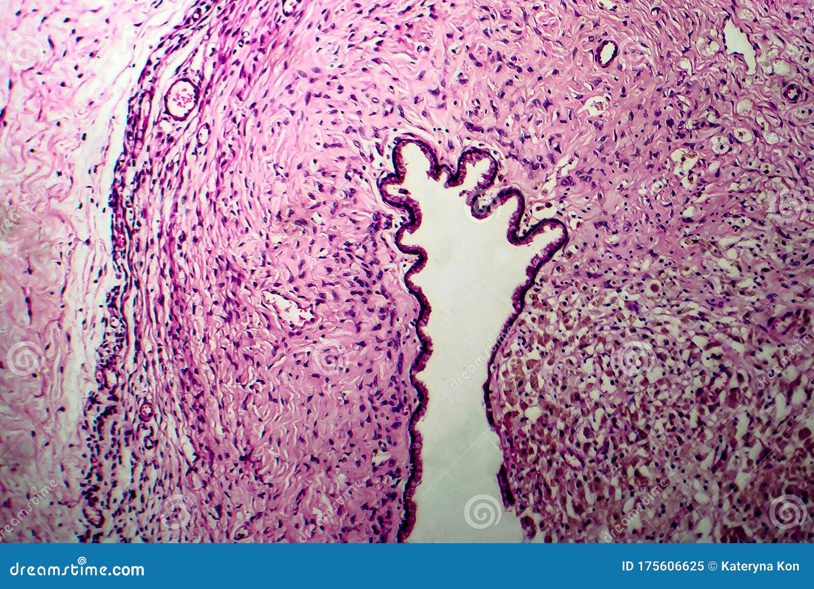 Ovarian Cyst, Light Micrograph Stock Image - Image of micro ...