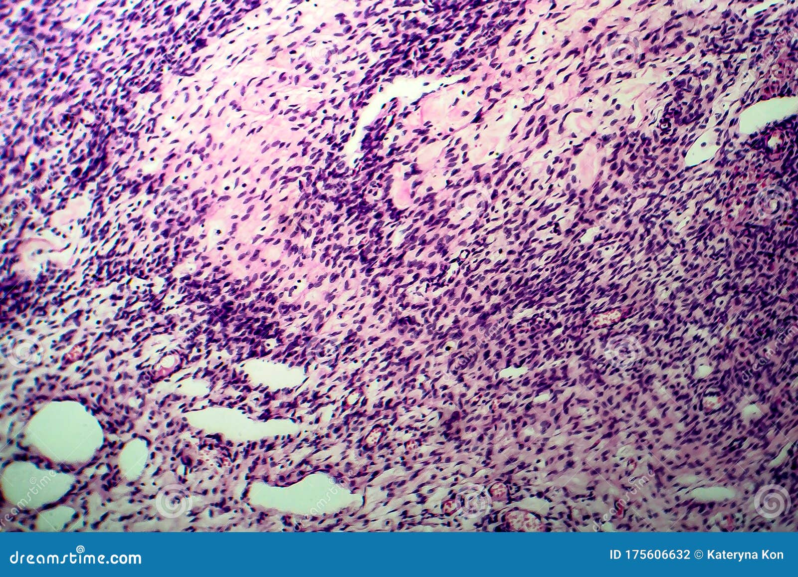 Ovarian Cyst, Light Micrograph Stock Photo - Image of gynecological ...