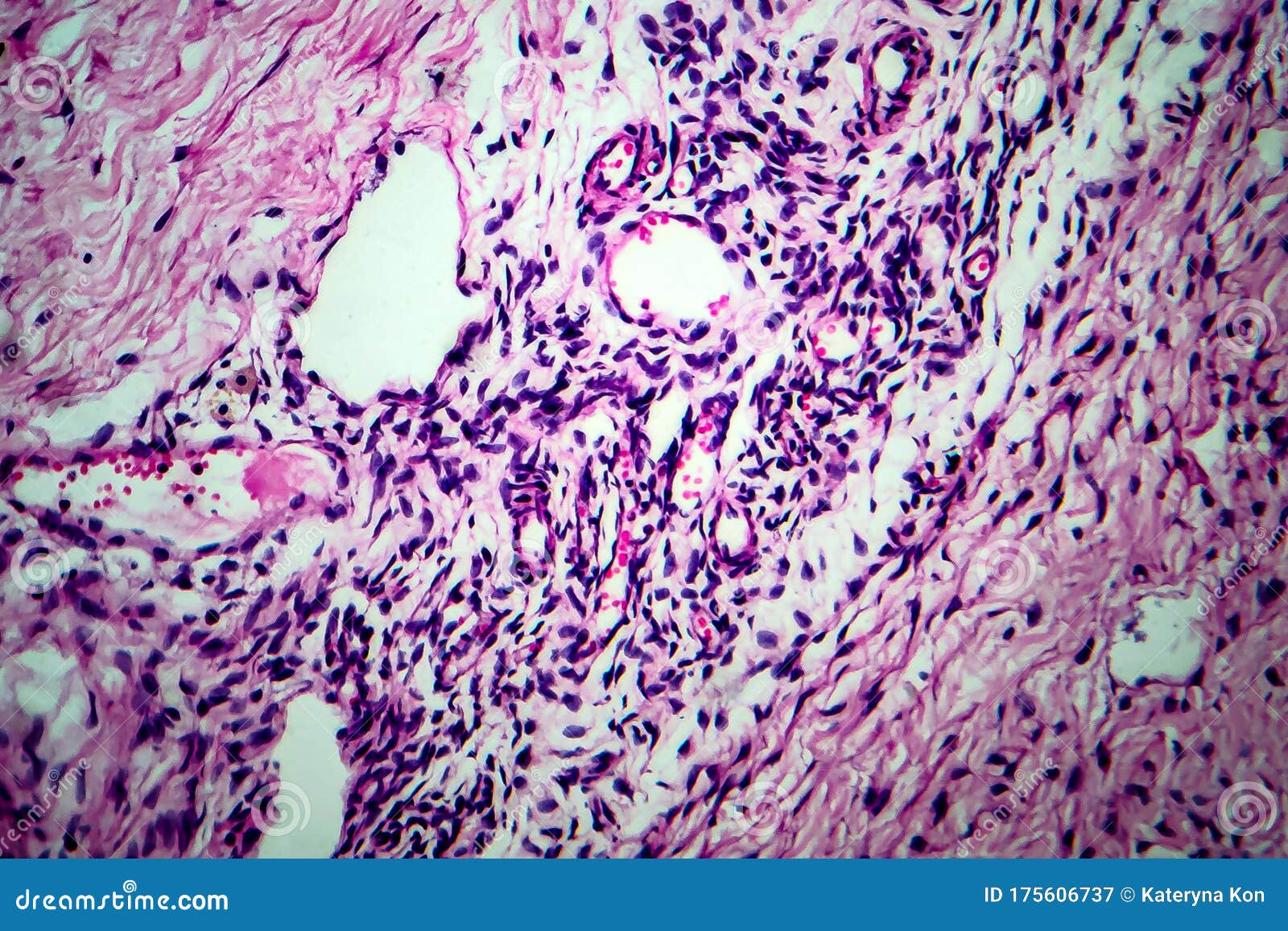 Ovarian Cyst, Light Micrograph Stock Image - Image of closeup ...