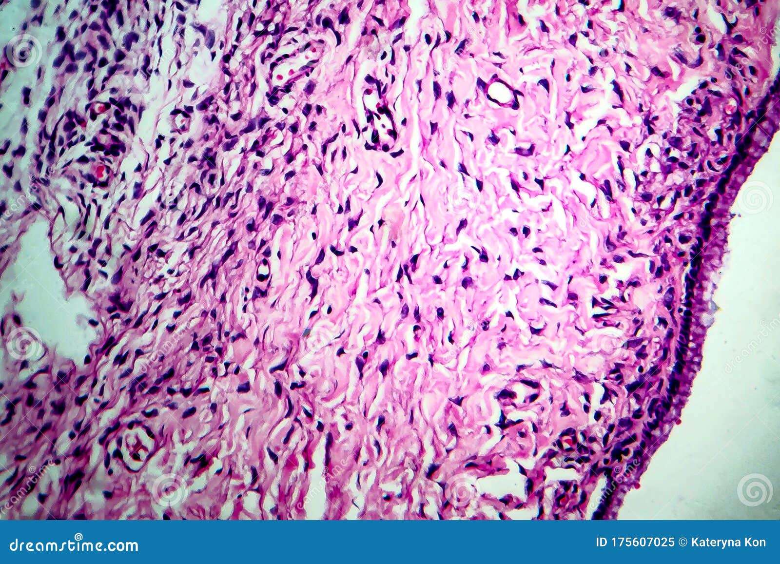 Ovarian Cyst, Light Micrograph Stock Image - Image of tumor ...