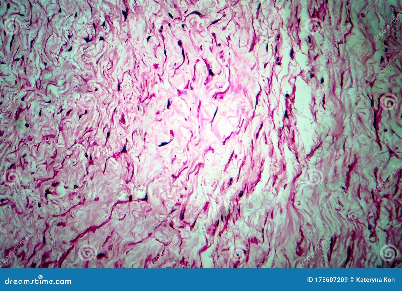 Ovarian Cyst, Light Micrograph Stock Image - Image of tissue ...