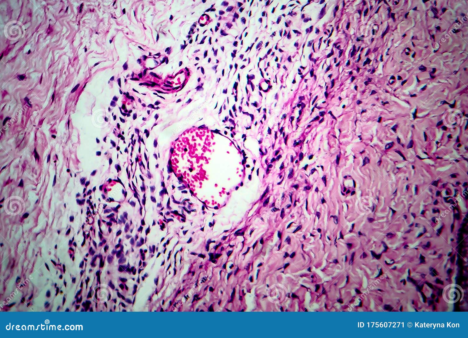 Ovarian Cyst, Light Micrograph Stock Image - Image of pathology ...