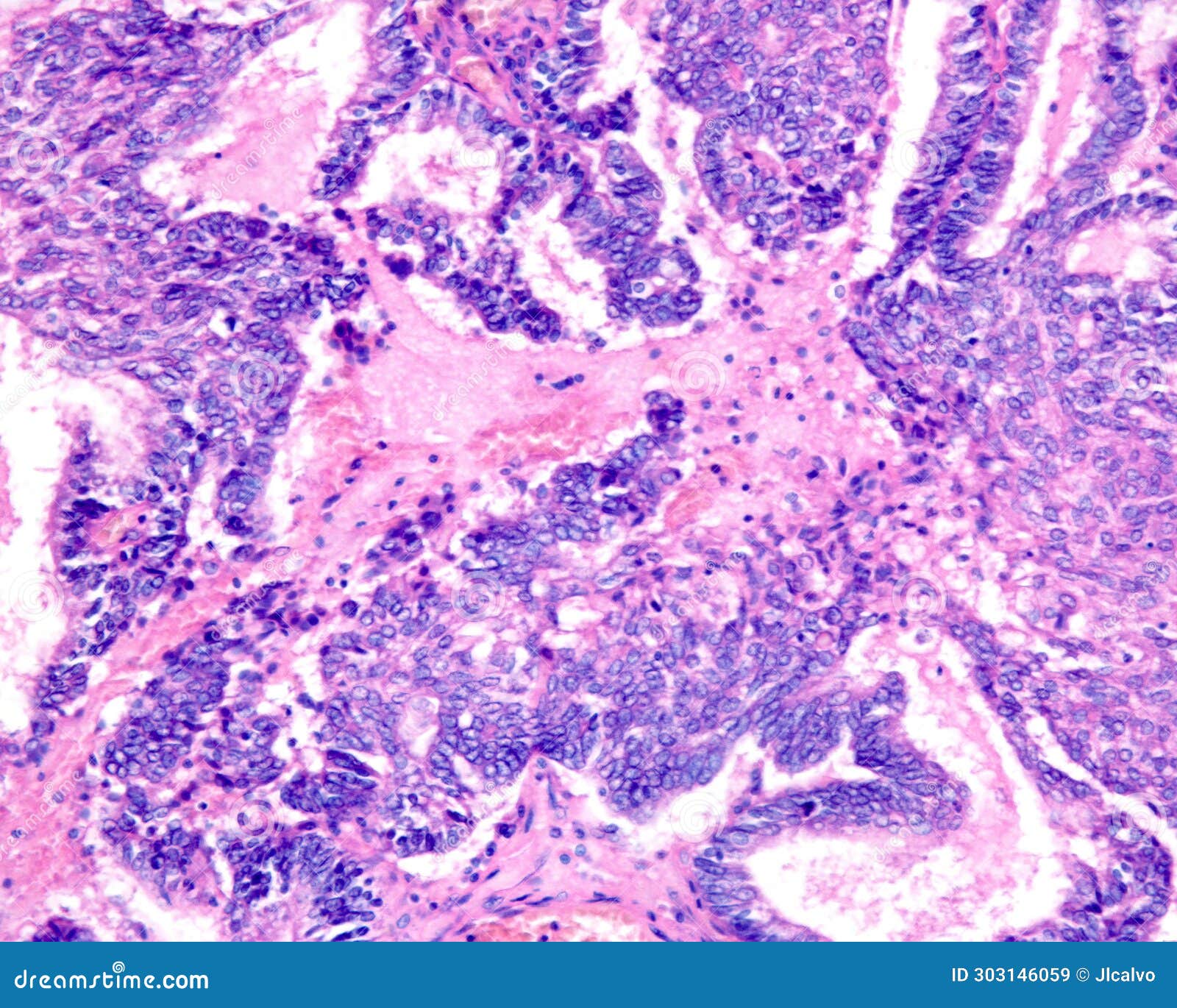 Ovarian epithelial cancer stock image. Image of human - 303146059
