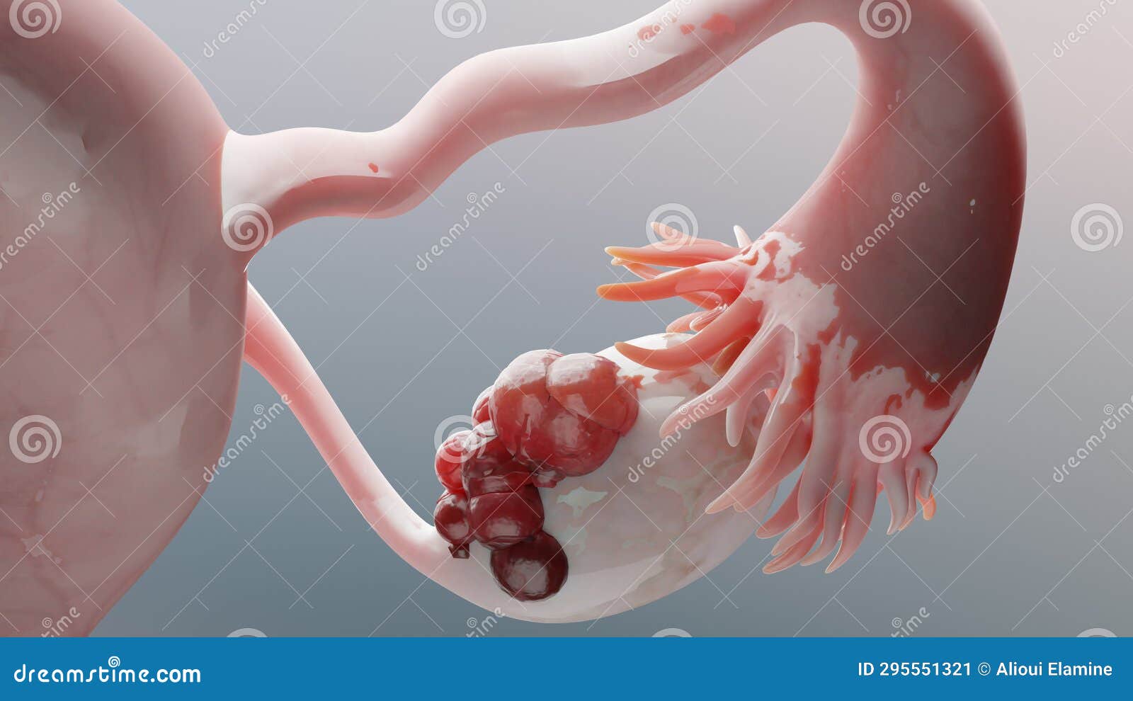 Ovarian Malignant Tumor Female Uterus Anatomy Reproductive System