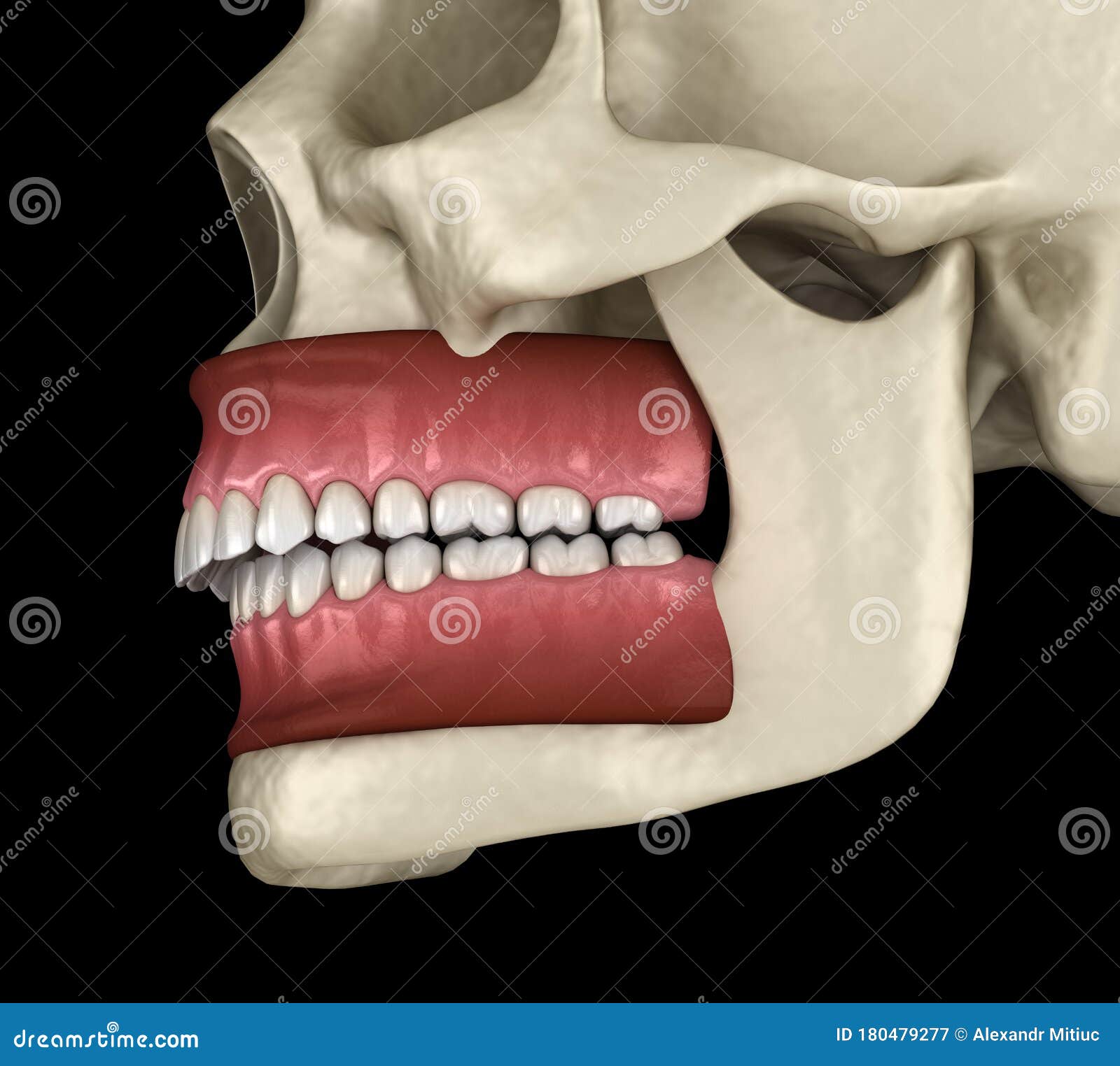 Overbite Dental Occlusion Malocclusion of Teeth . Medically Accurate ...