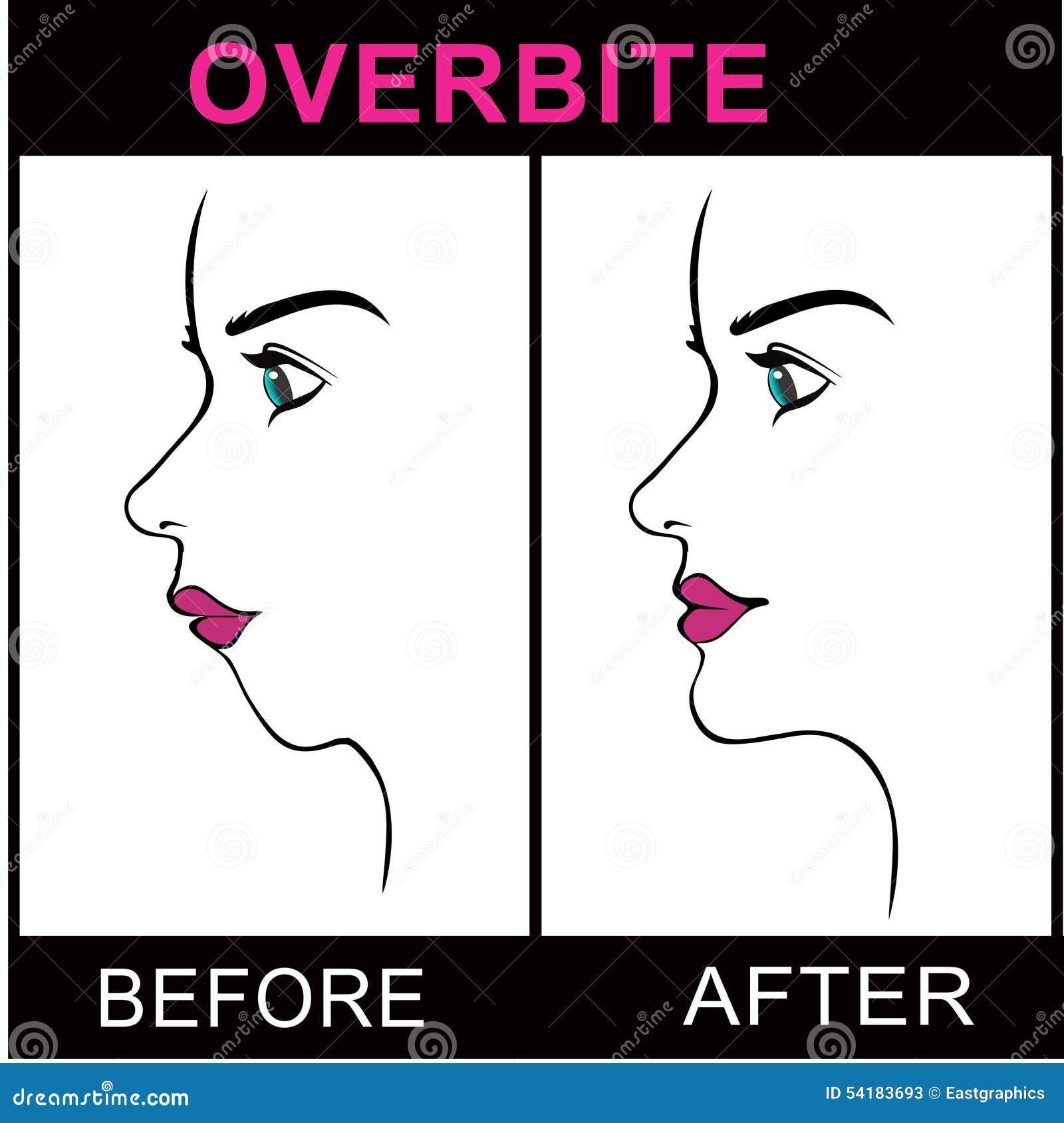 Overbite Cartoon Vector | CartoonDealer.com #54183693