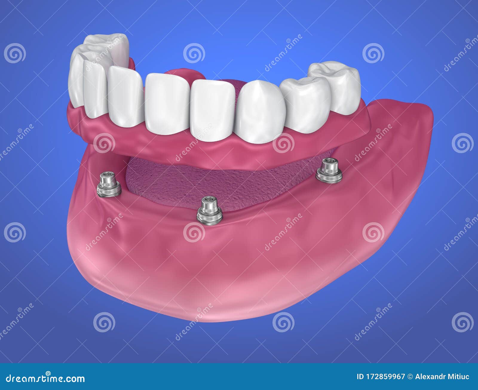 Overdenture Transparent Icon. Overdenture Symbol Design From Den Vector ...